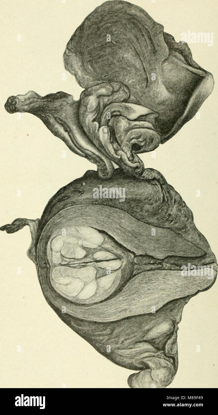 Fibroids and allied tumours (myoma and adenomyoma) - their pathology ...