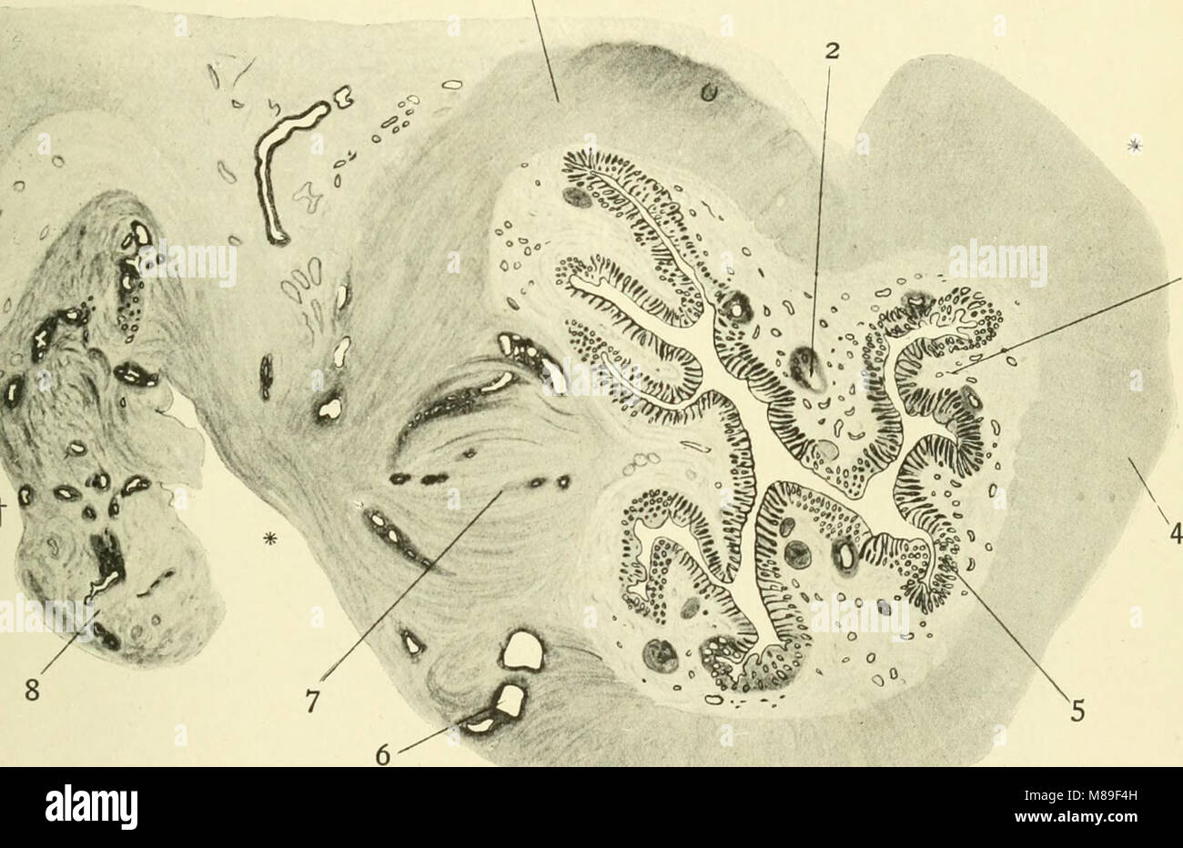Fibroids and allied tumours (myoma and adenomyoma) - their pathology ...