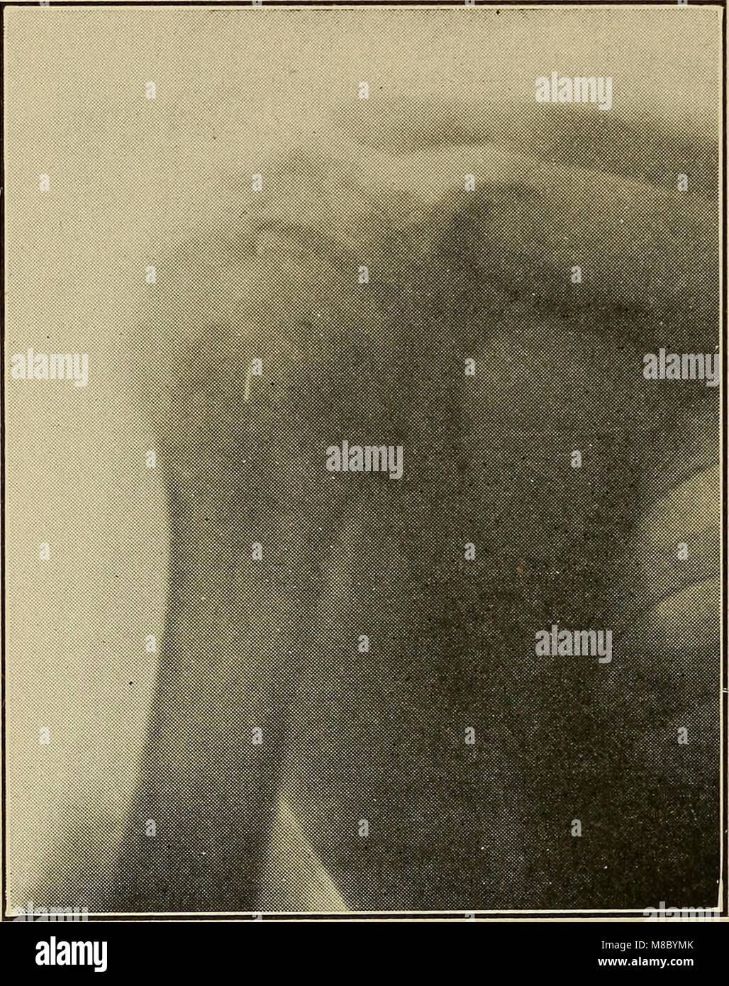 A 1914 medical text discussing various diseases affecting bones and ...