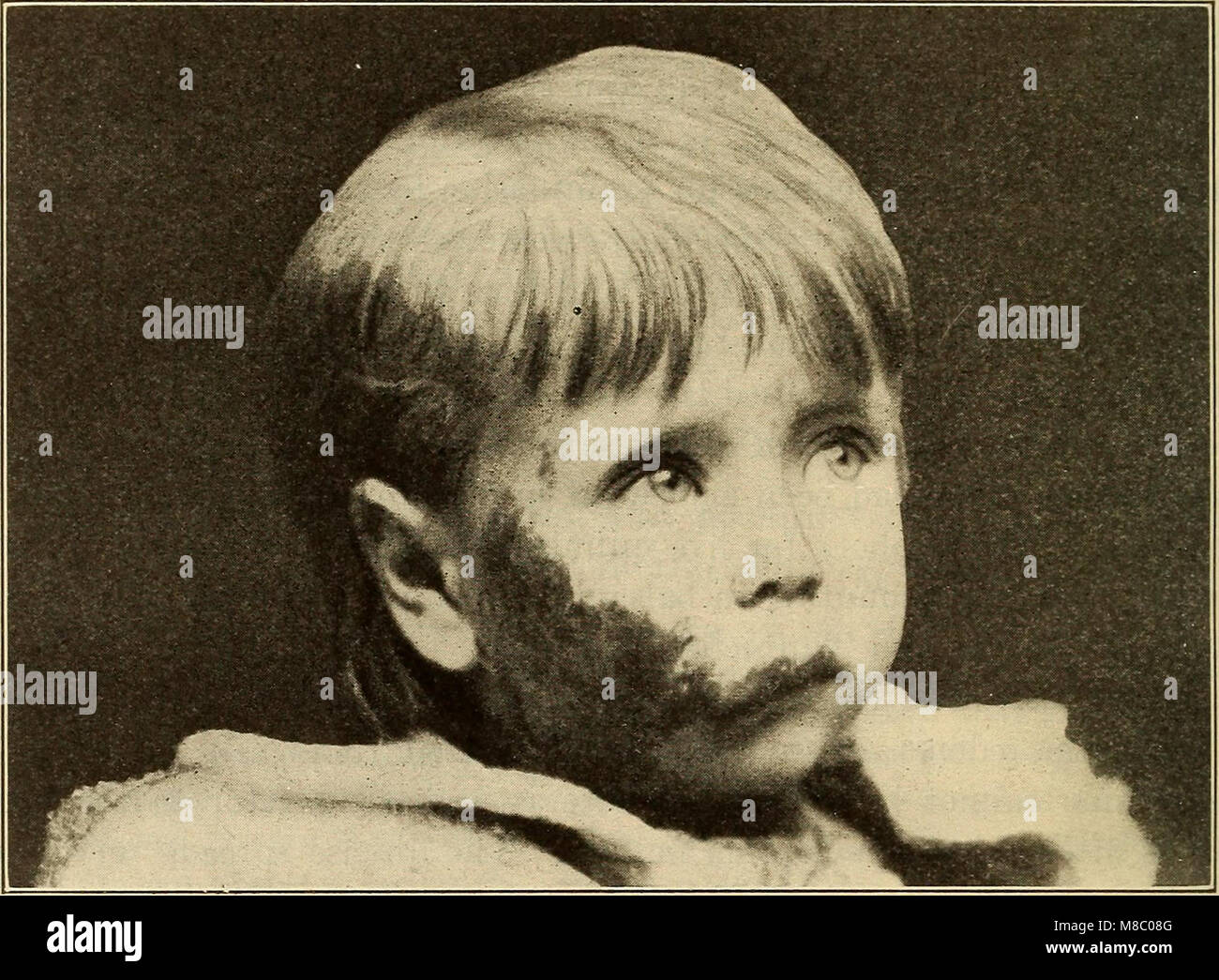 Vintage childhood diseases hi-res stock photography and images - Alamy