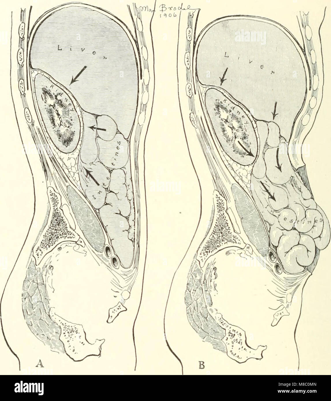 Diseases of the kidneys, ureters and bladder, with special reference to ...