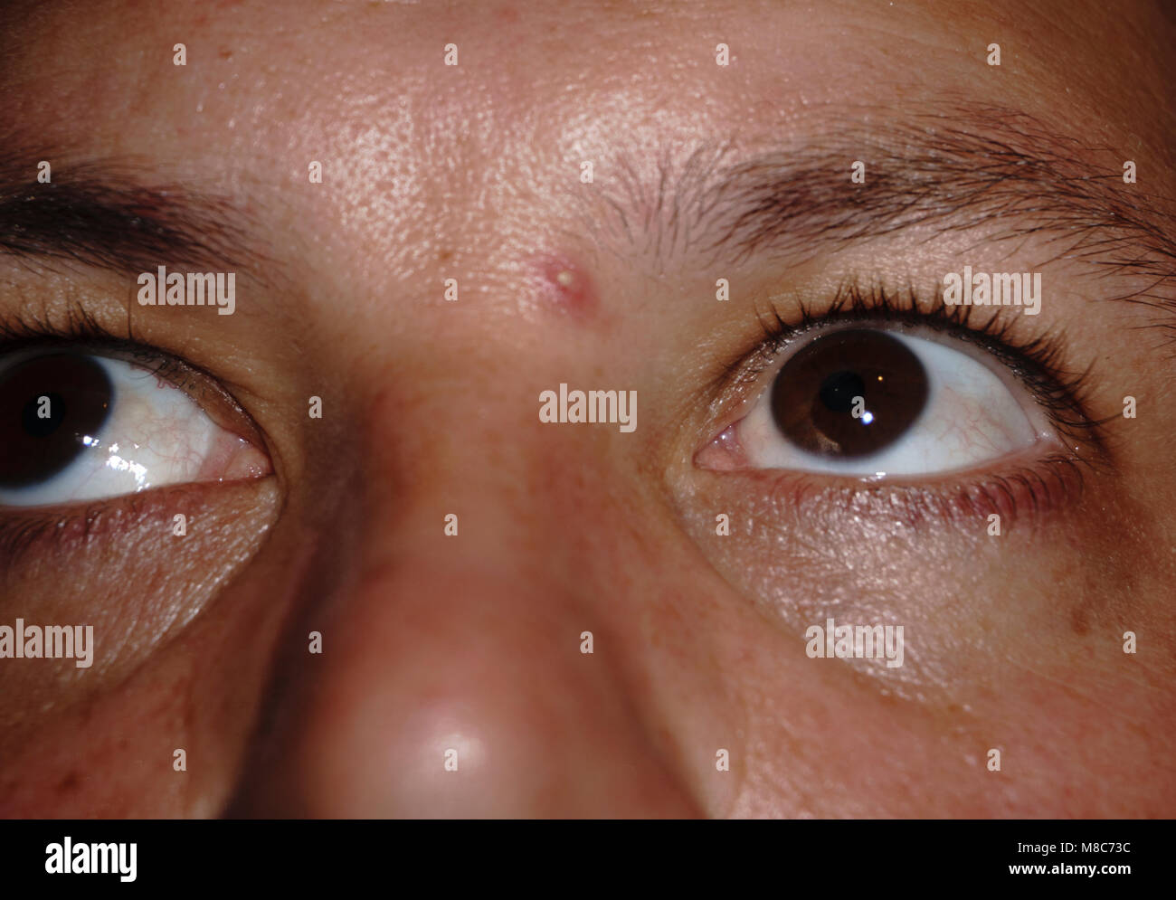 pimple on the skin close-up Stock Photo - Alamy