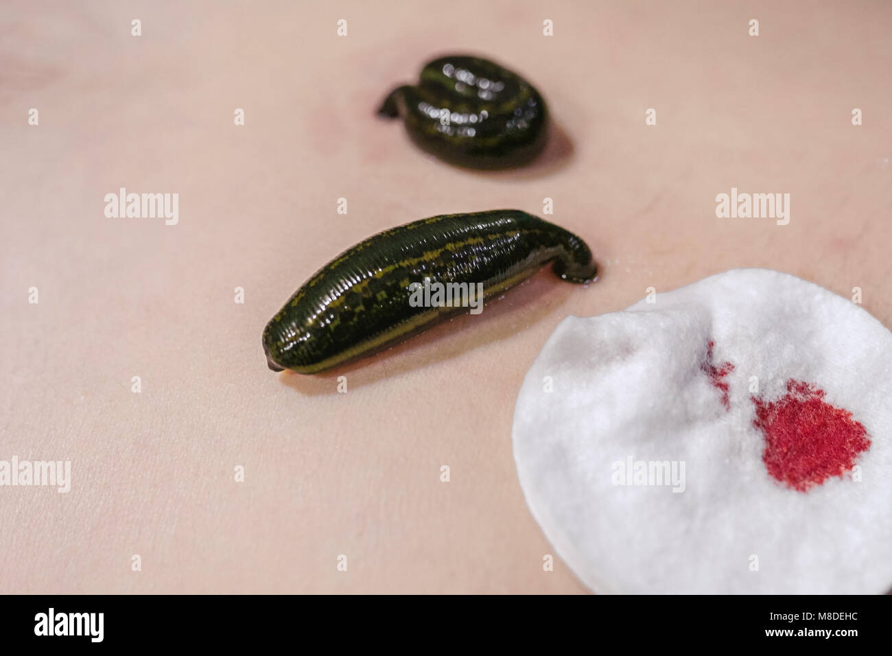 Leech Bite Stock Photos & Leech Bite Stock Images - Alamy
