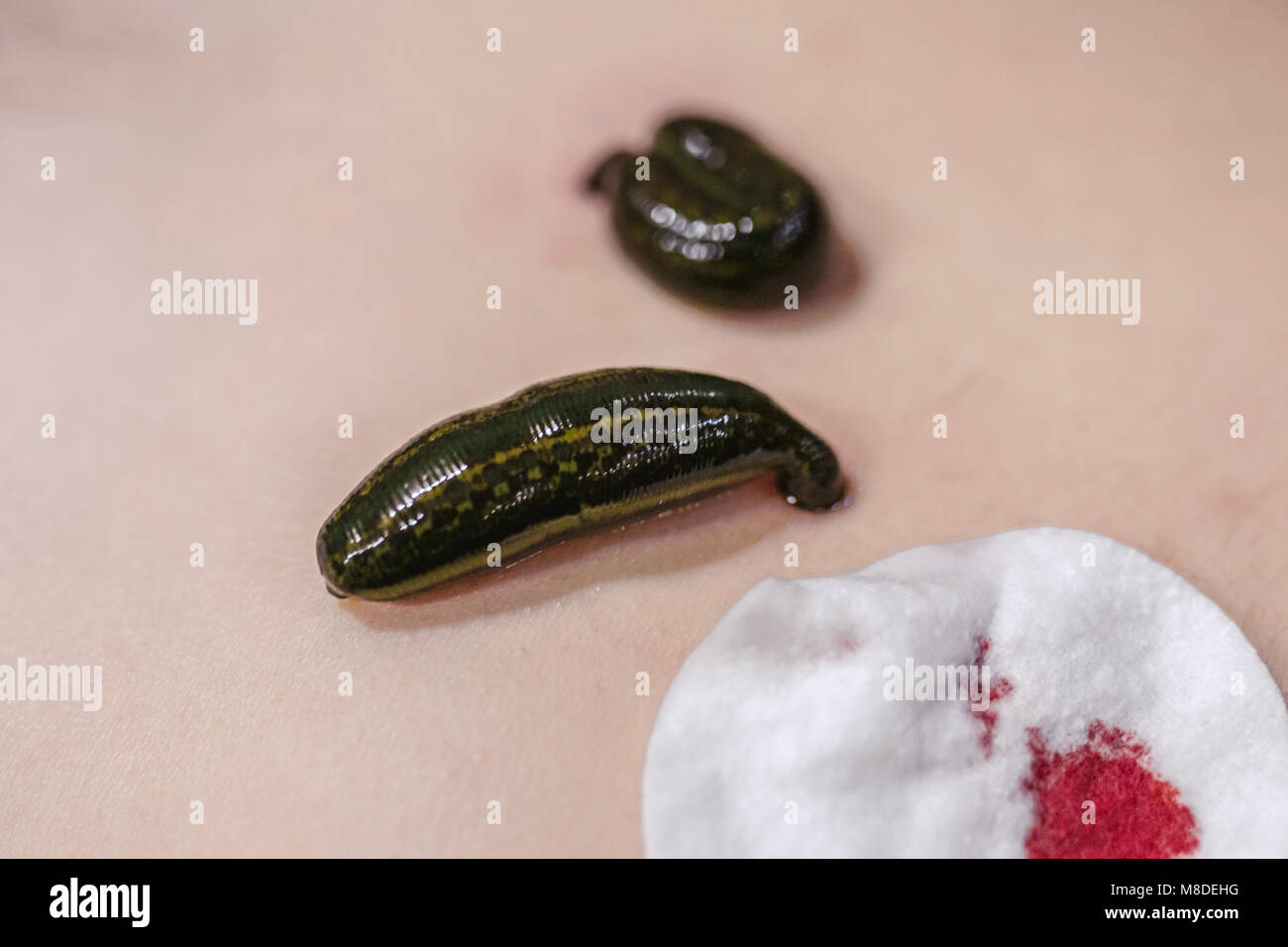 Leeches on his stomach in the liver area and the navel Stock Photo - Alamy