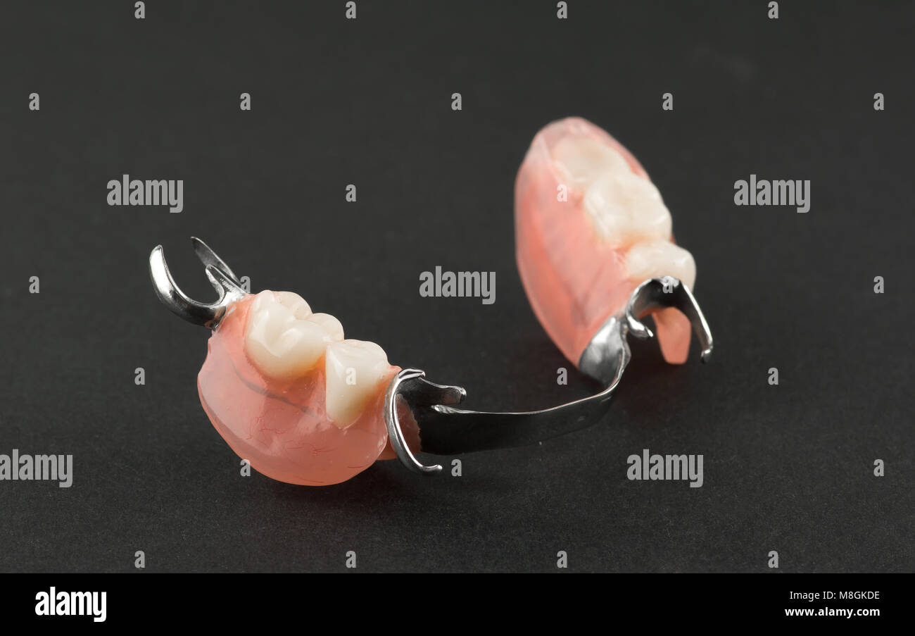 Elements of a clasp prosthesis close-up isolated on a black background ...