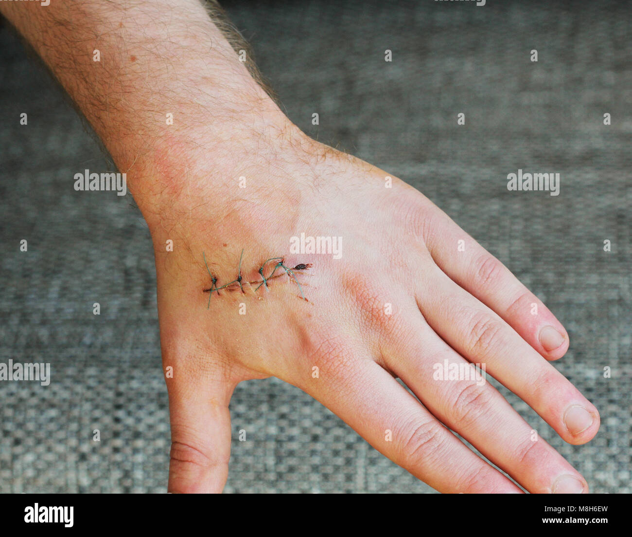 Hands in dark suture wound on hand. Pain of accident concept Stock ...