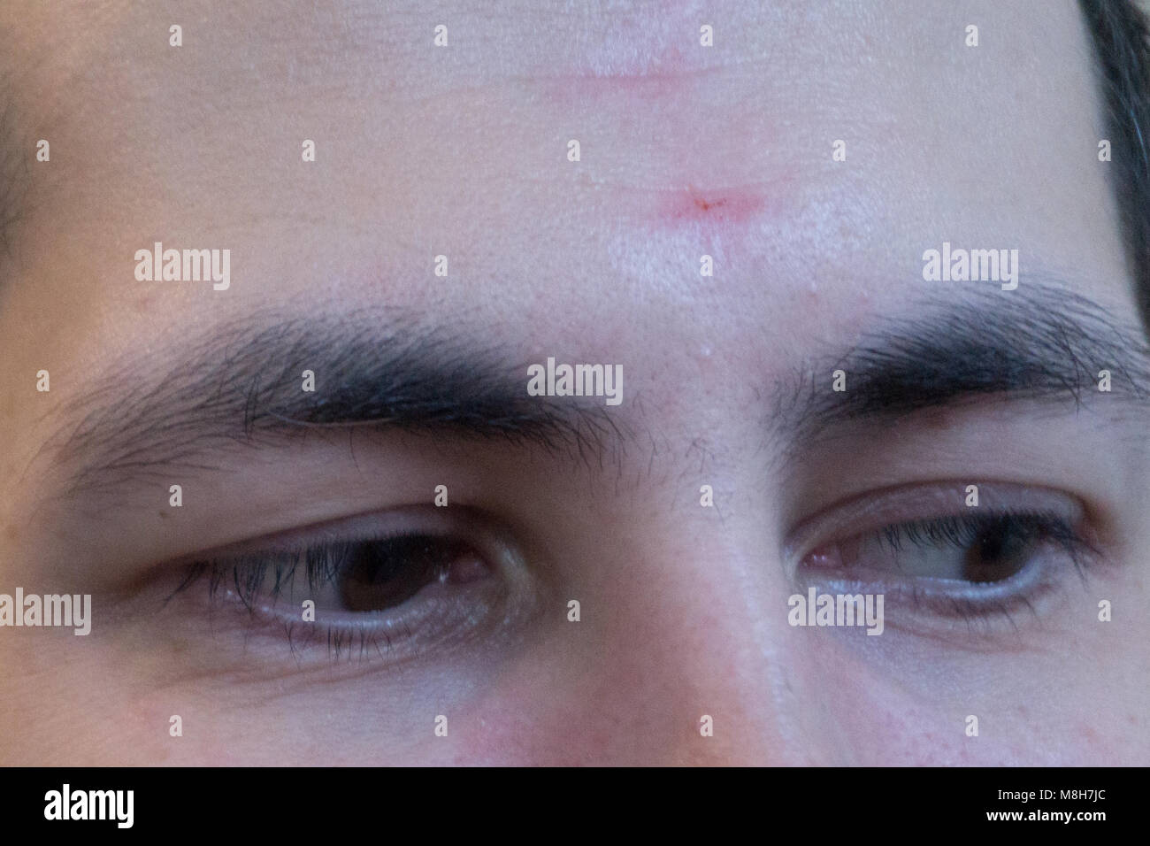 Blisters caused by shingles on left face skin After the onset of ...