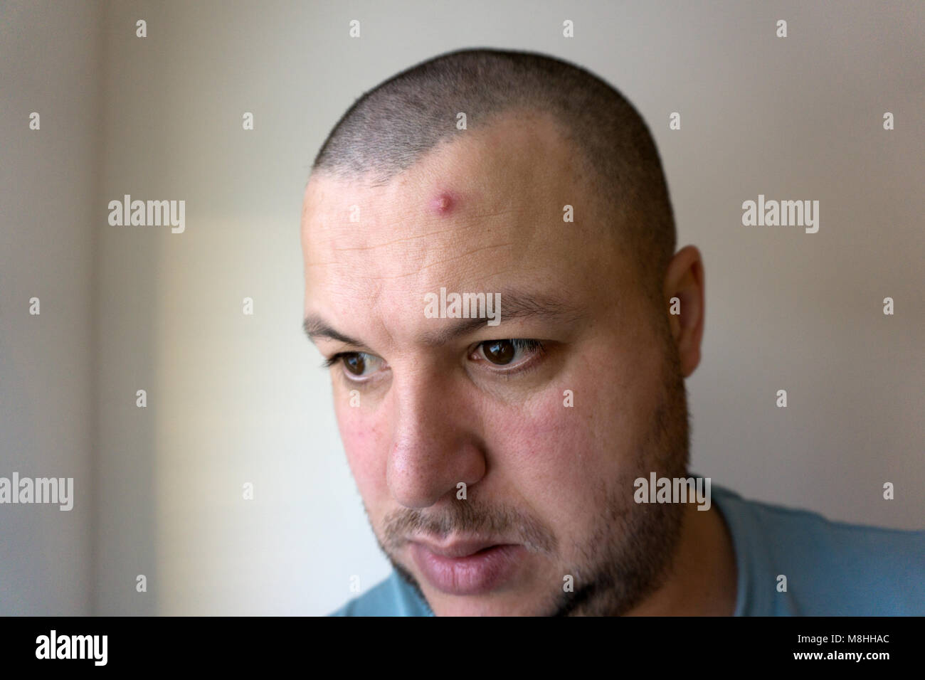 Pustule psoriasis hi-res stock photography and images - Alamy