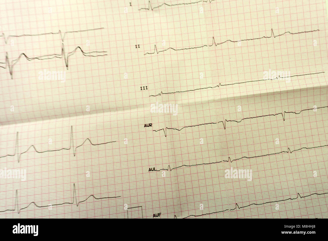 ecg cardiology ecg analysis analyze beat Stock Photo - Alamy
