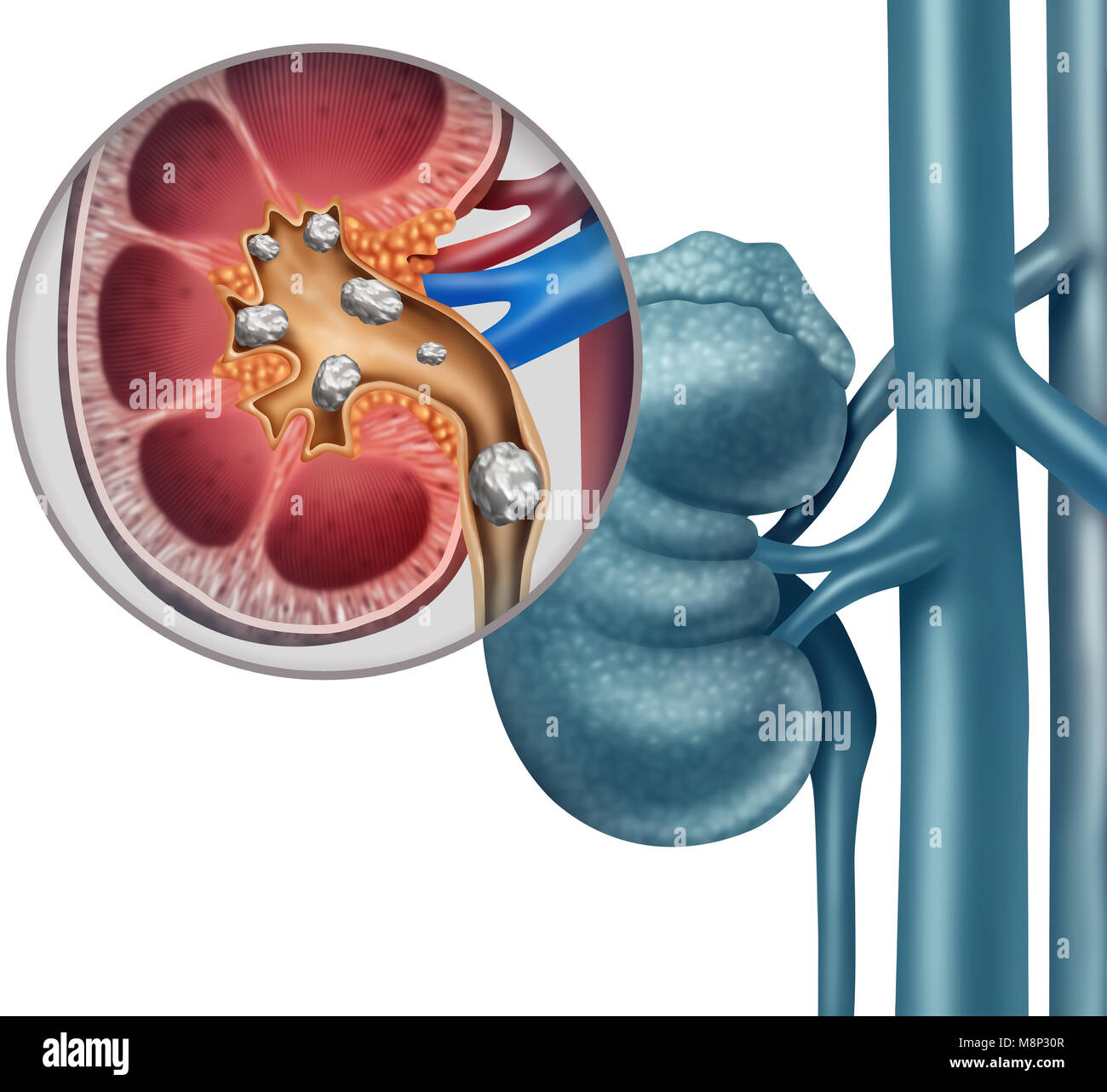 Kidney stone medical concept as an organ with painful crystaline ...