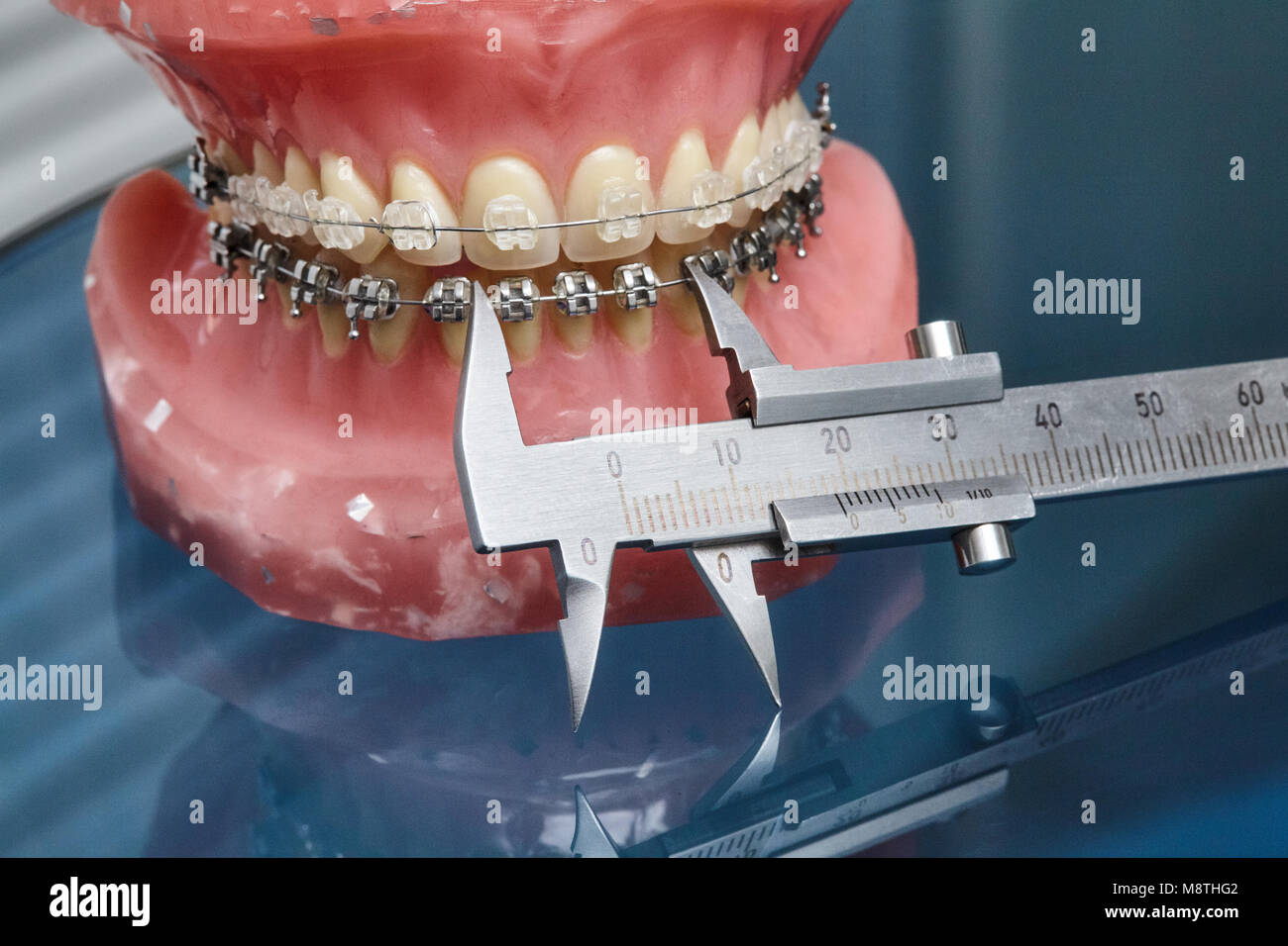 Human jaw or teeth model with metal wired dental braces and vernier ...