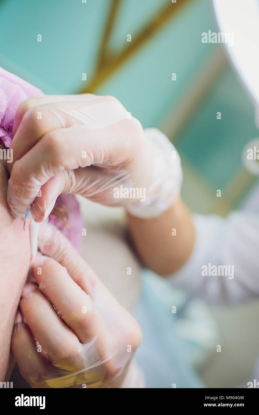 Professional holding the needle cannula on hand. Closeup. Female Stock ...