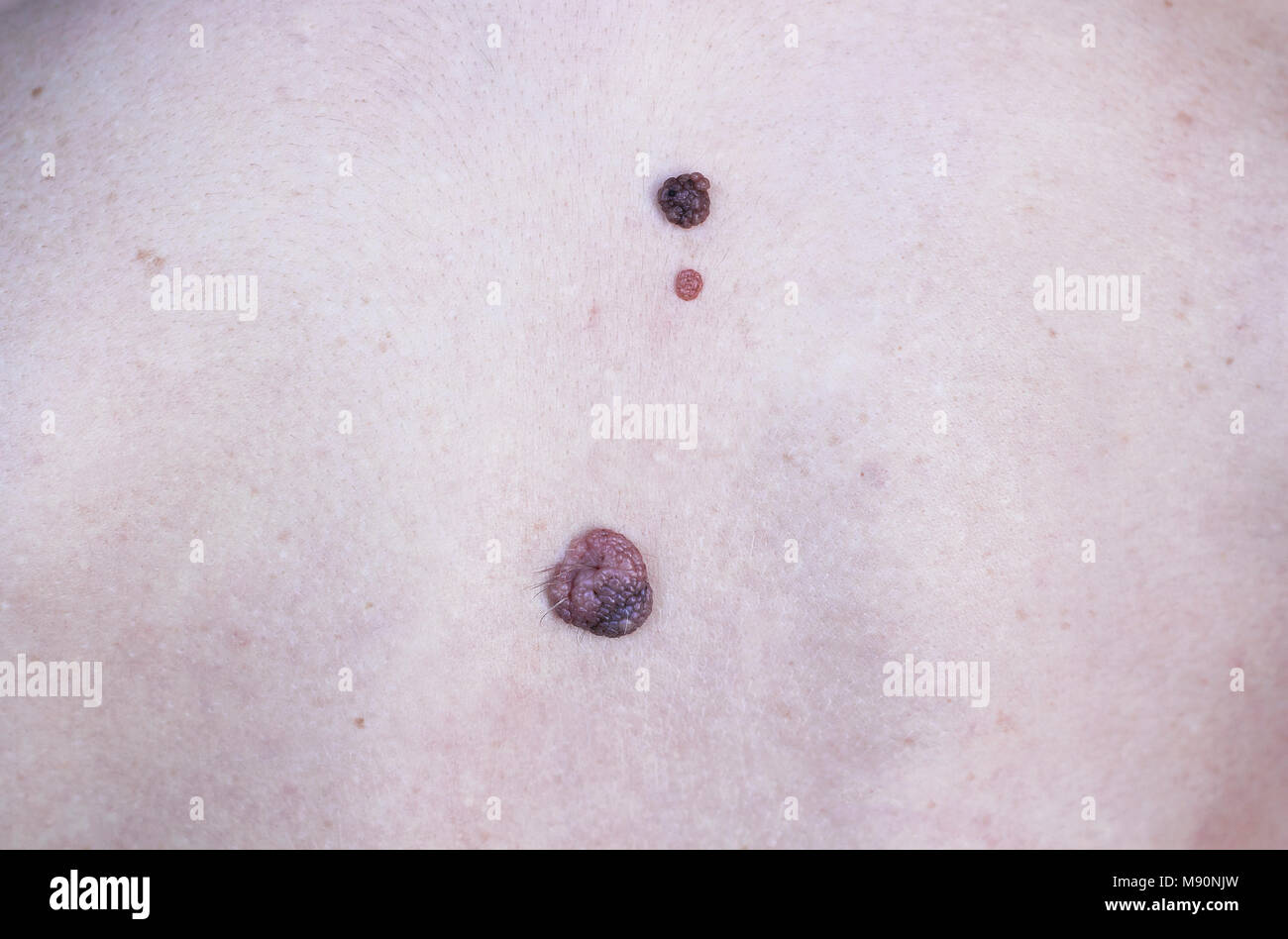 Woman Back Skin Mole High Resolution Stock Photography and Images - Alamy