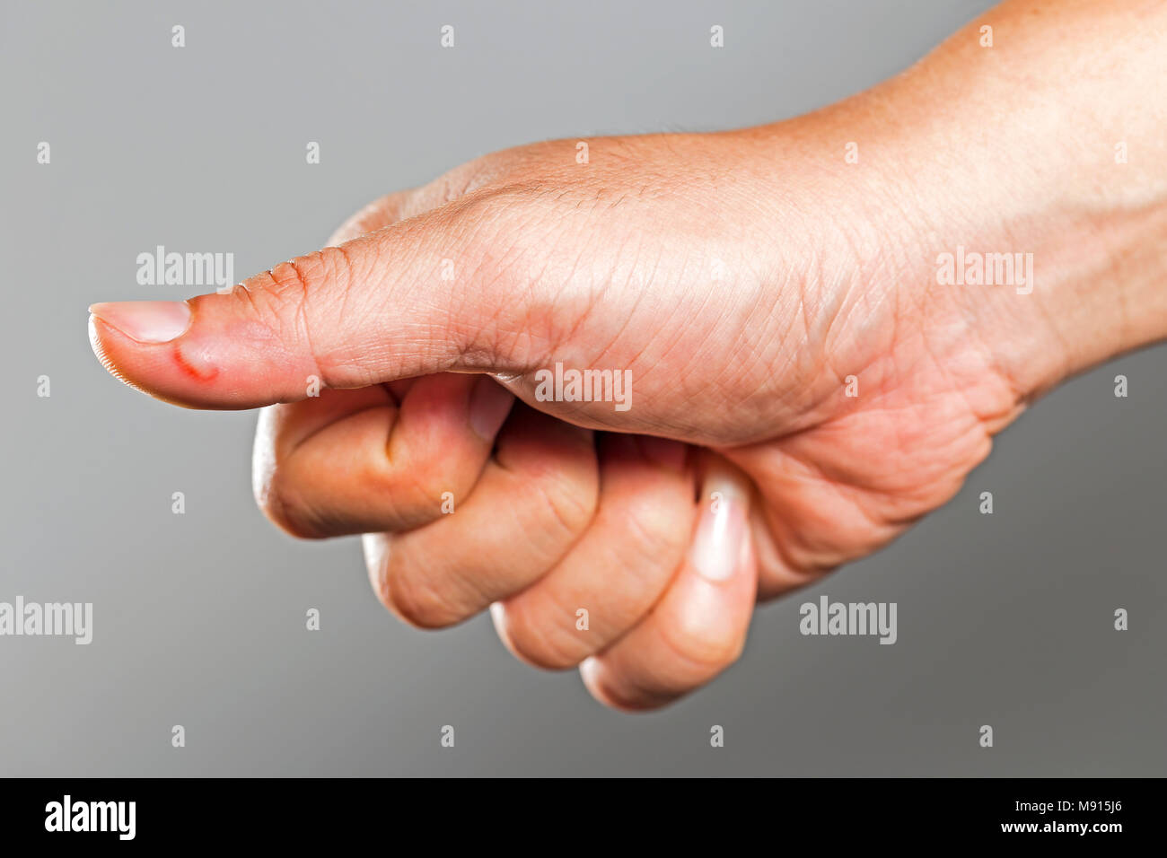 Skin ulcers hi-res stock photography and images - Alamy