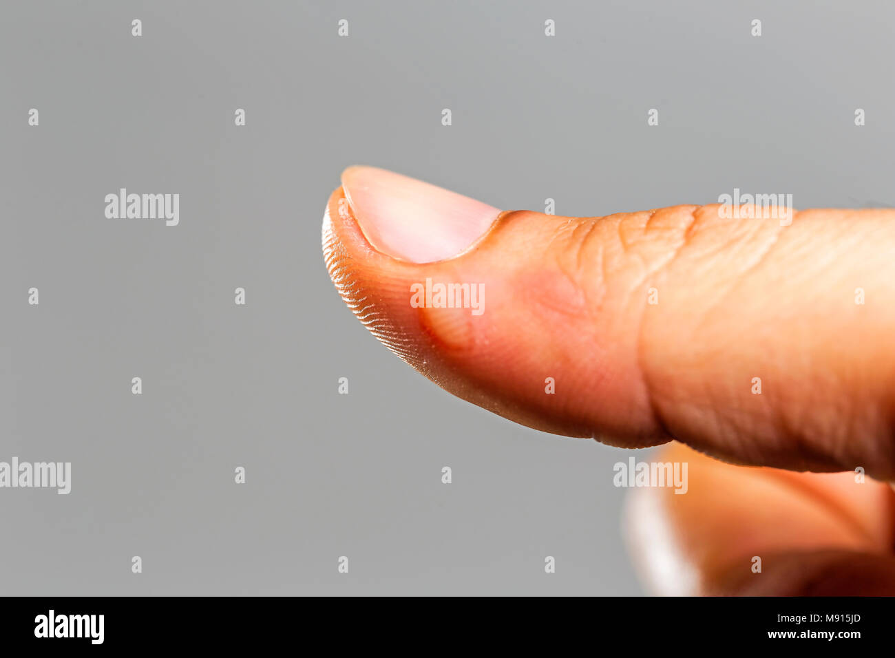 Blister skin hi-res stock photography and images - Alamy