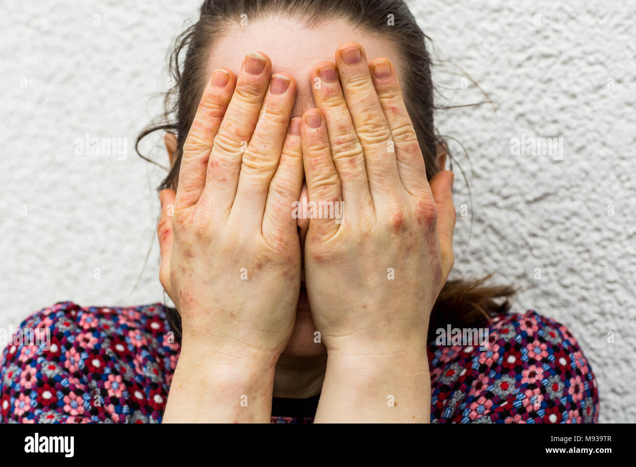 Dyshidrotic Eczema Face