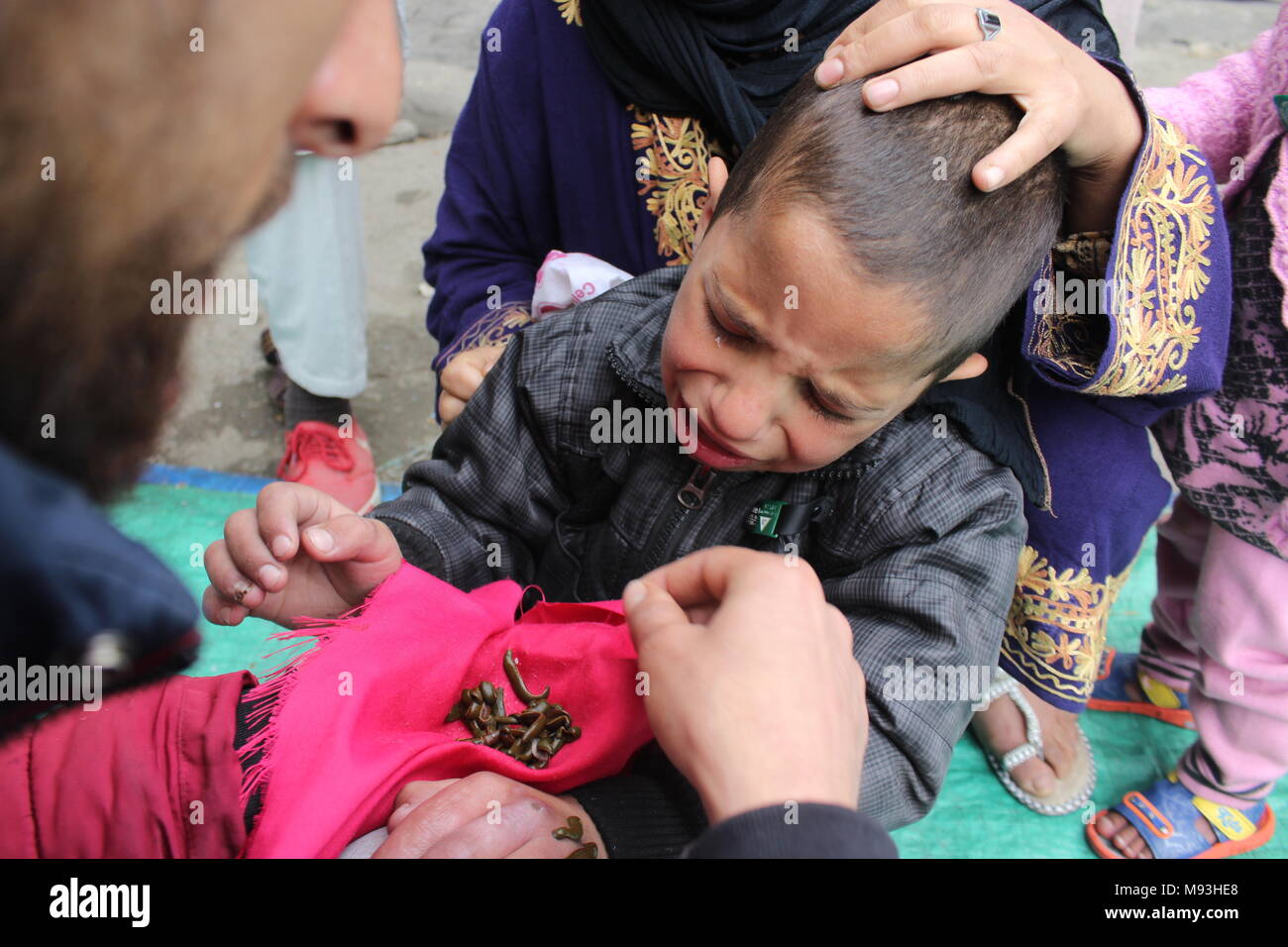 Srinagar, India. 21st Mar, 2018. A local Kashmiris receives leeches ...