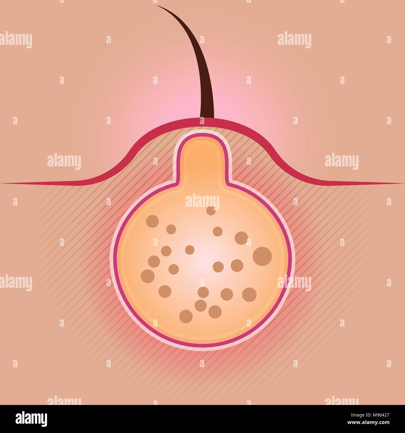 Acne skin inflammation. Medical vector illustration of pimple formation ...
