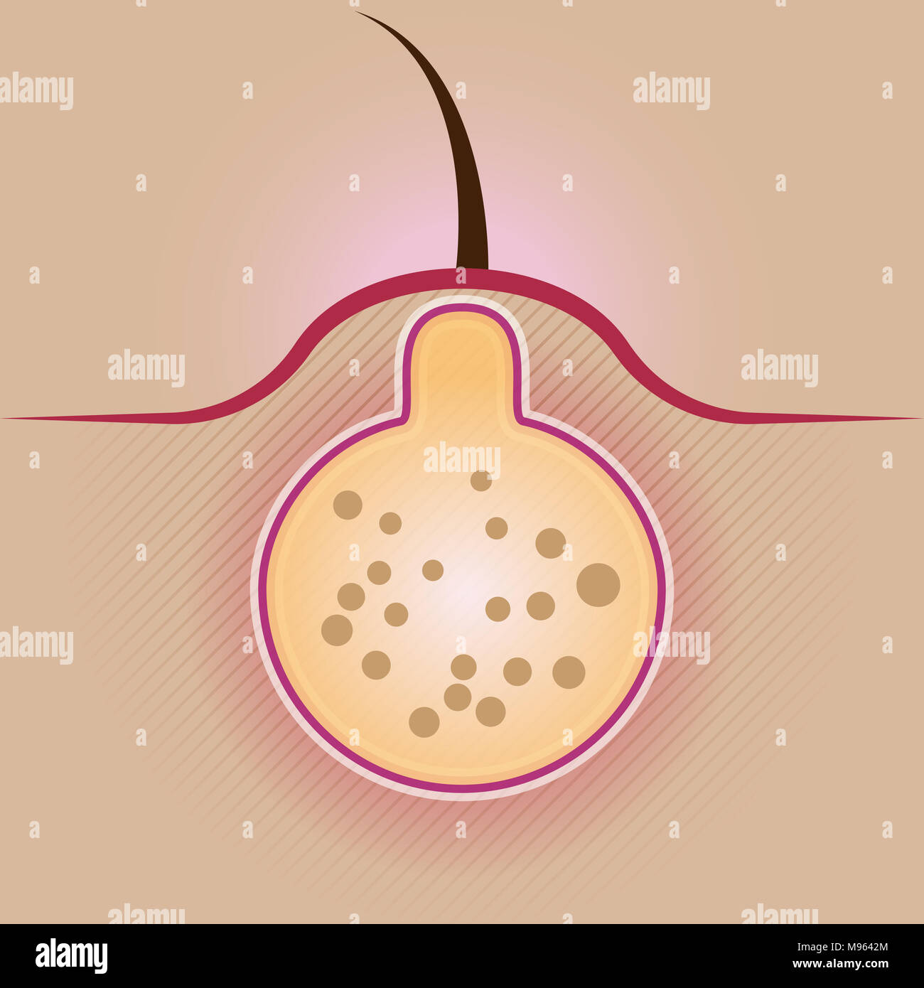 Acne skin inflammation. Medical illustration of pimple formation Stock ...