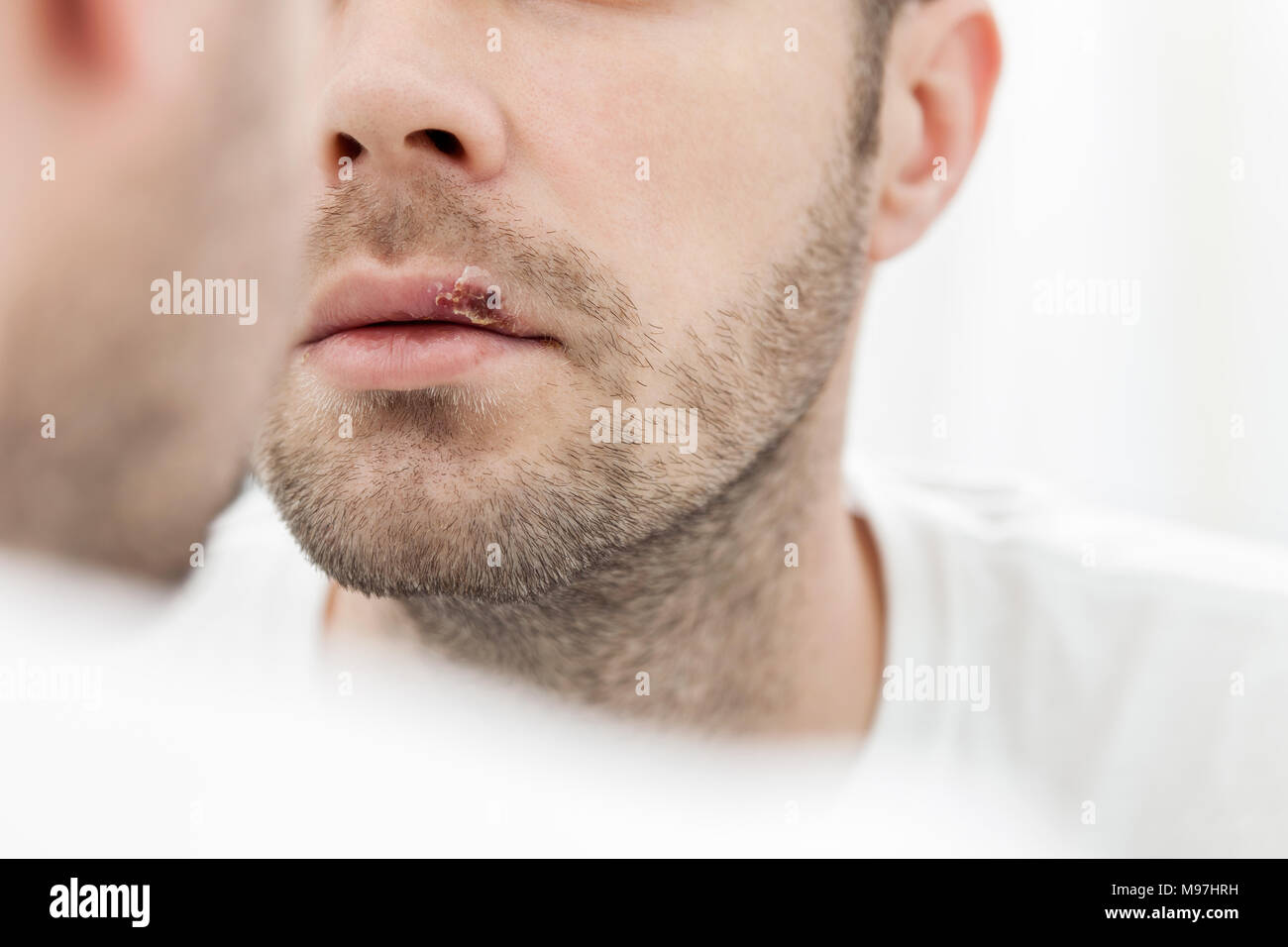 Man swollen face suffering hi-res stock photography and images - Alamy
