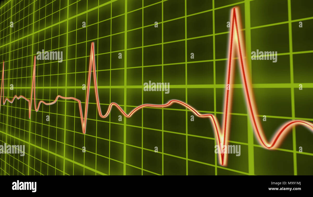 Normal sinus rhythm hi-res stock photography and images - Alamy