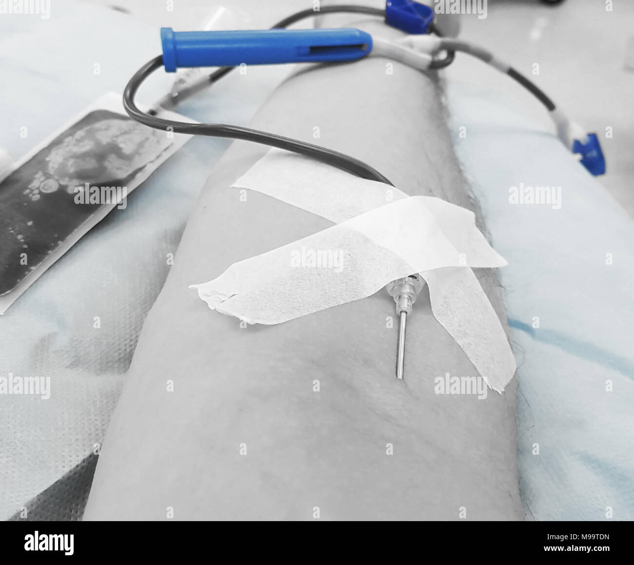 a man's arm during a blood transfusion at the hospital's emergency ...