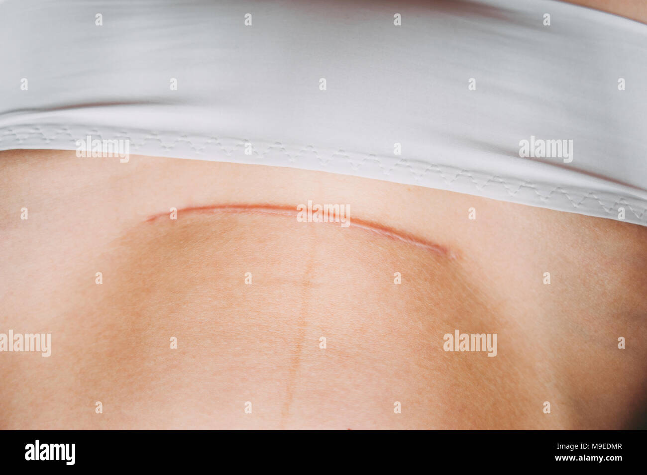 Cesarean Scar High Resolution Stock Photography and Images - Alamy