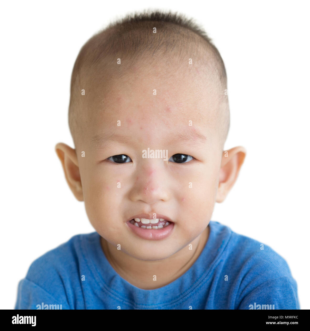Two years old Asian toddler with red rashes on face. Portrait of young ...