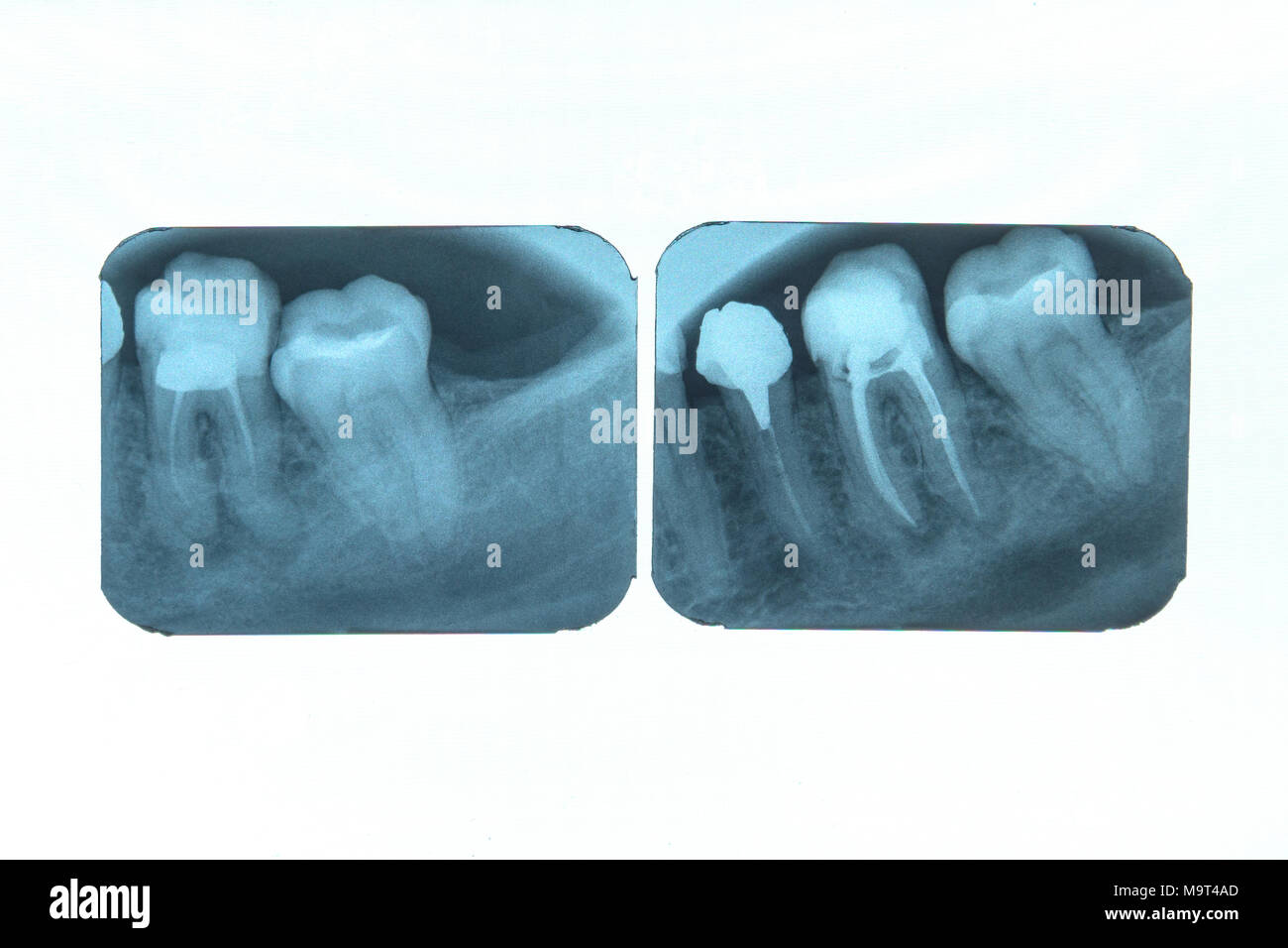 Panoramic x ray image Cut Out Stock Images & Pictures - Alamy