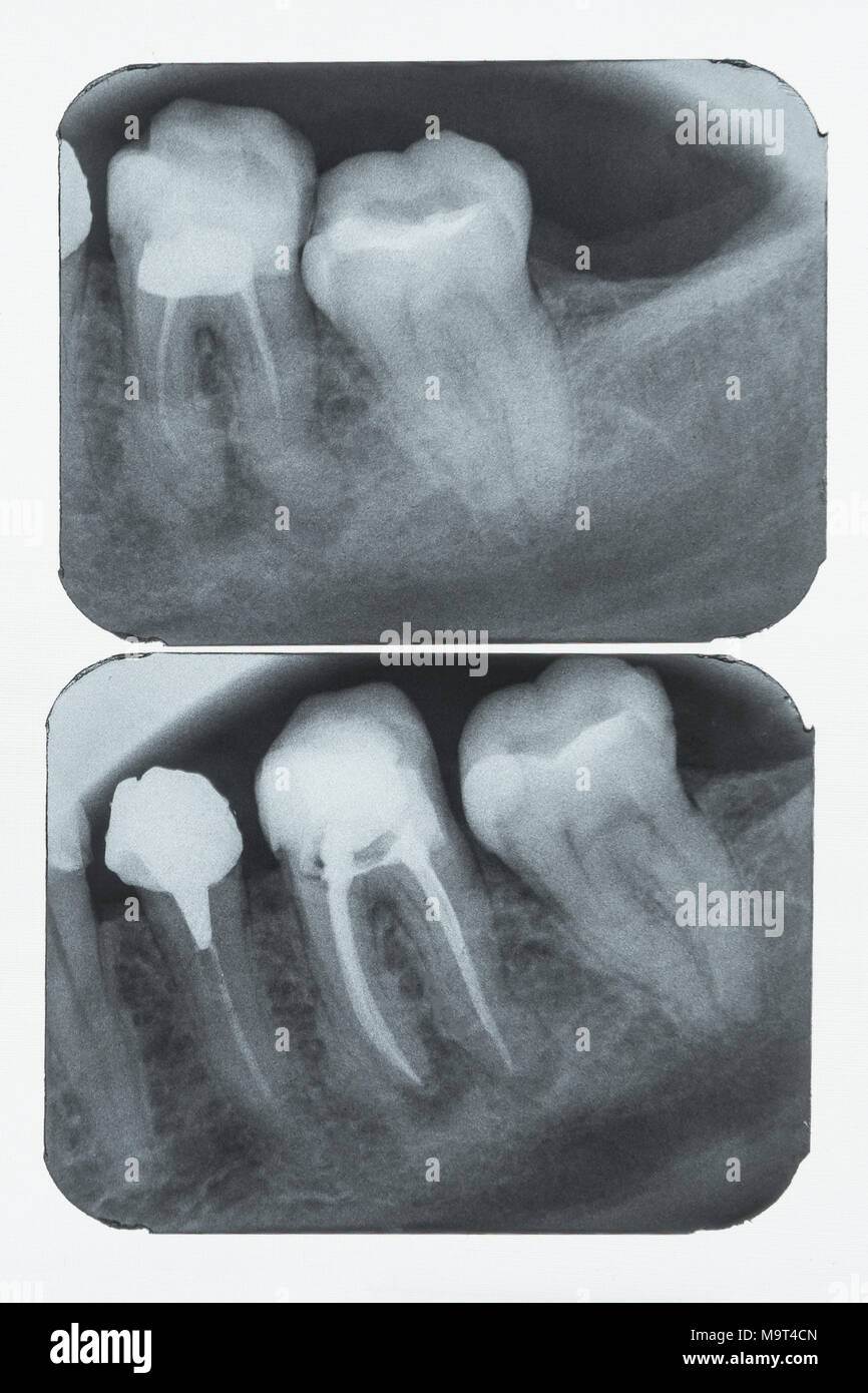 Pulpitis illustration hi-res stock photography and images - Alamy