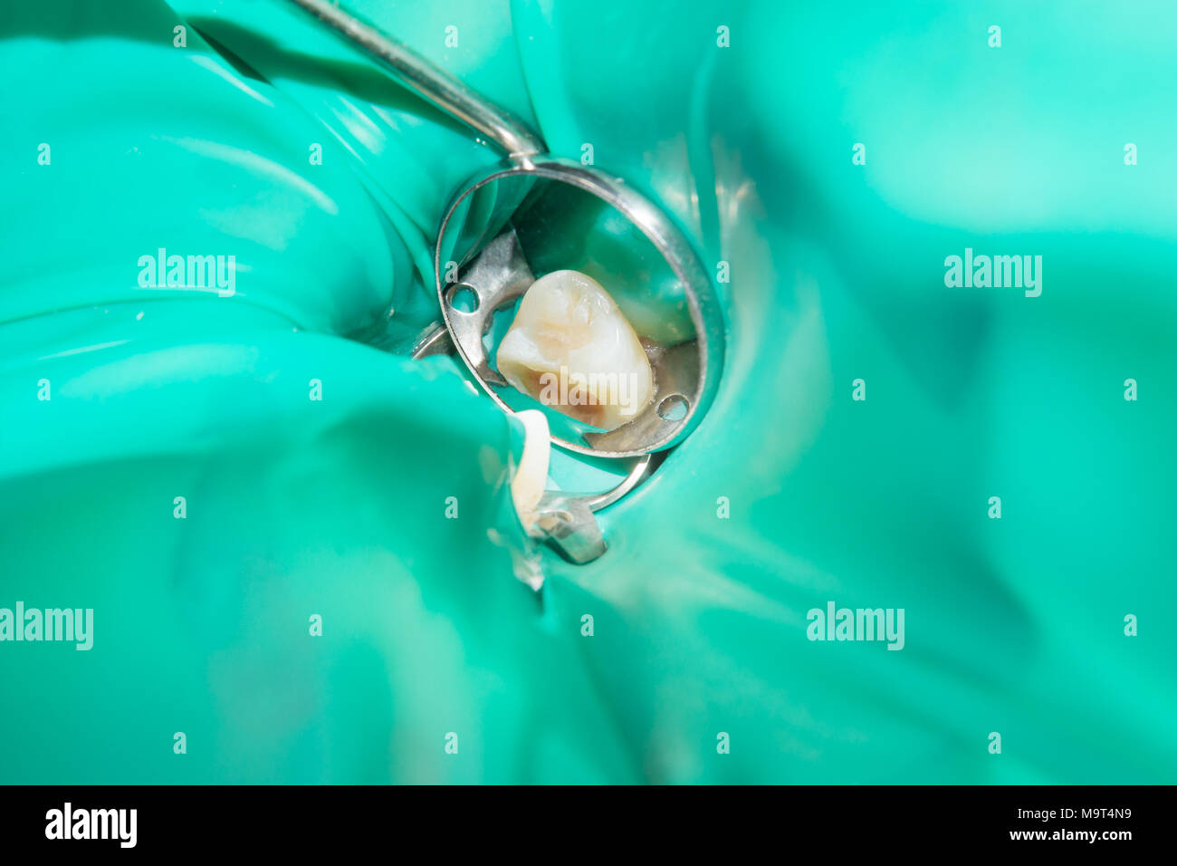 close-up of a human rotten carious tooth at the treatment stage in a ...