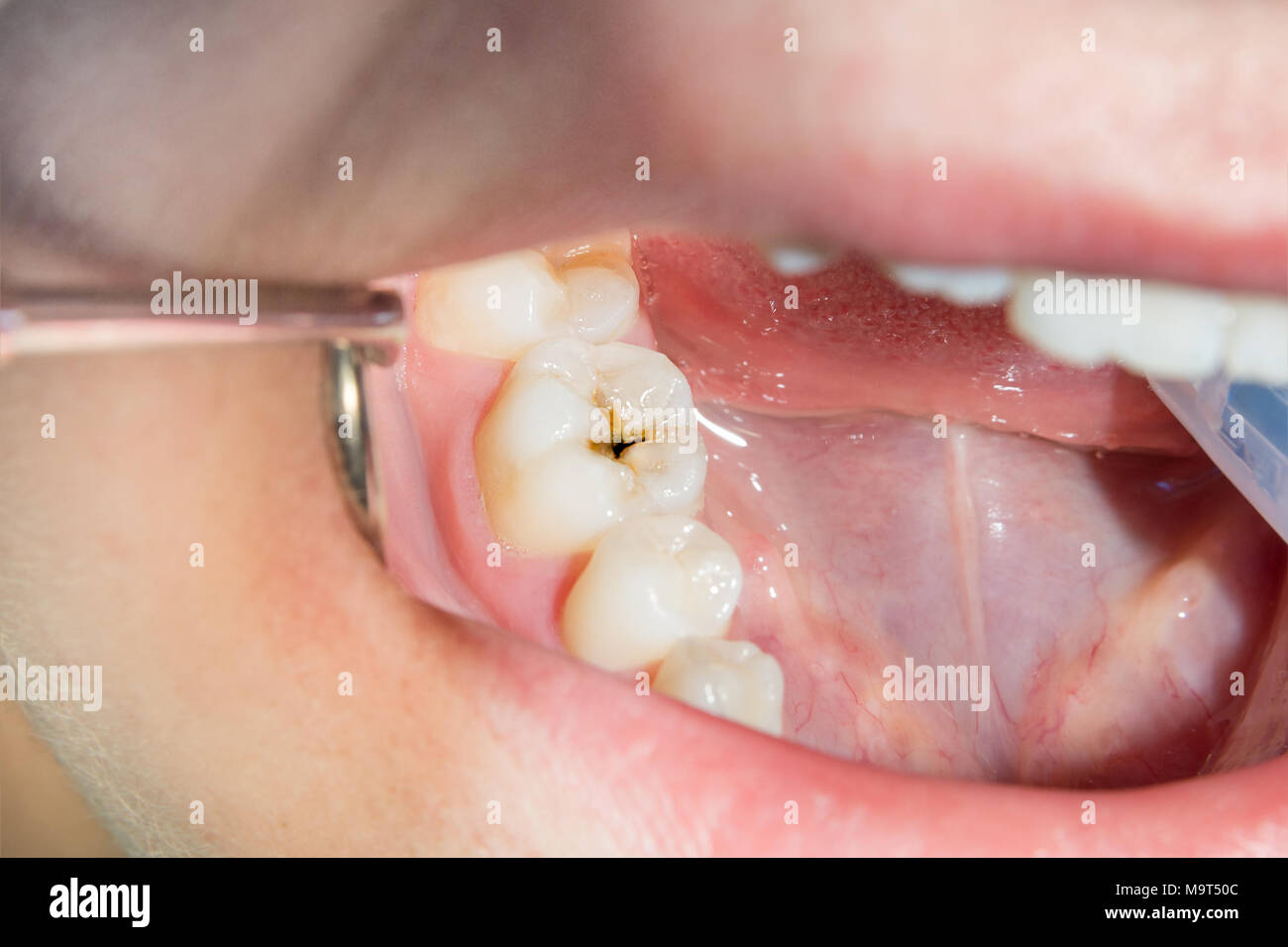 close-up of a human rotten carious tooth at the treatment stage in a ...