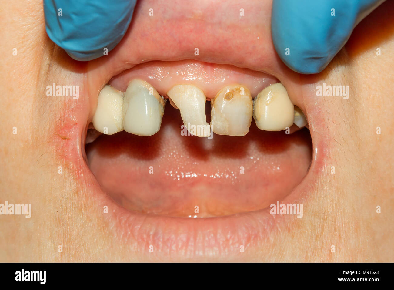 close-up of a human rotten carious tooth at the treatment stage in a ...