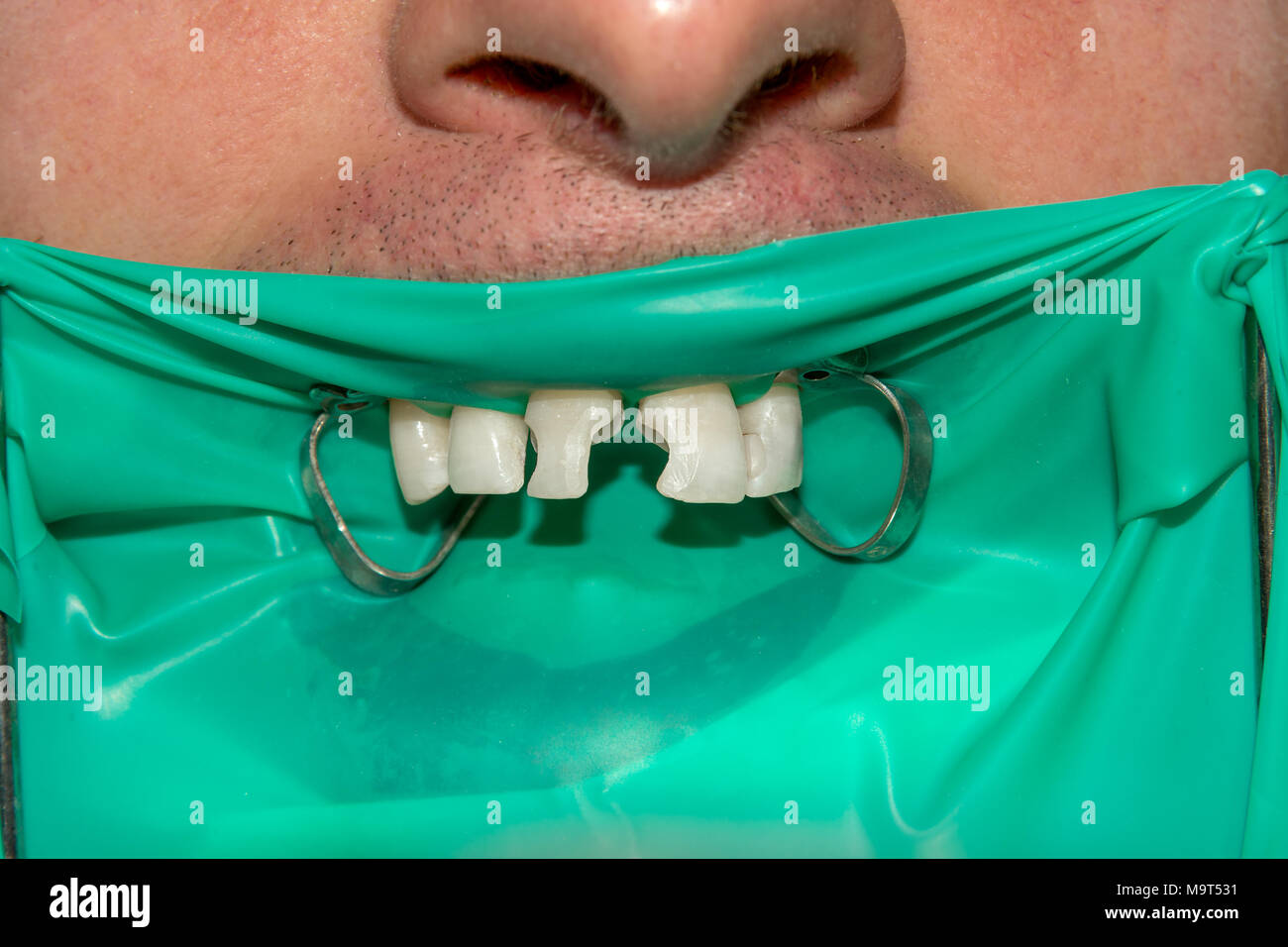 close-up of a human rotten carious tooth at the treatment stage in a ...