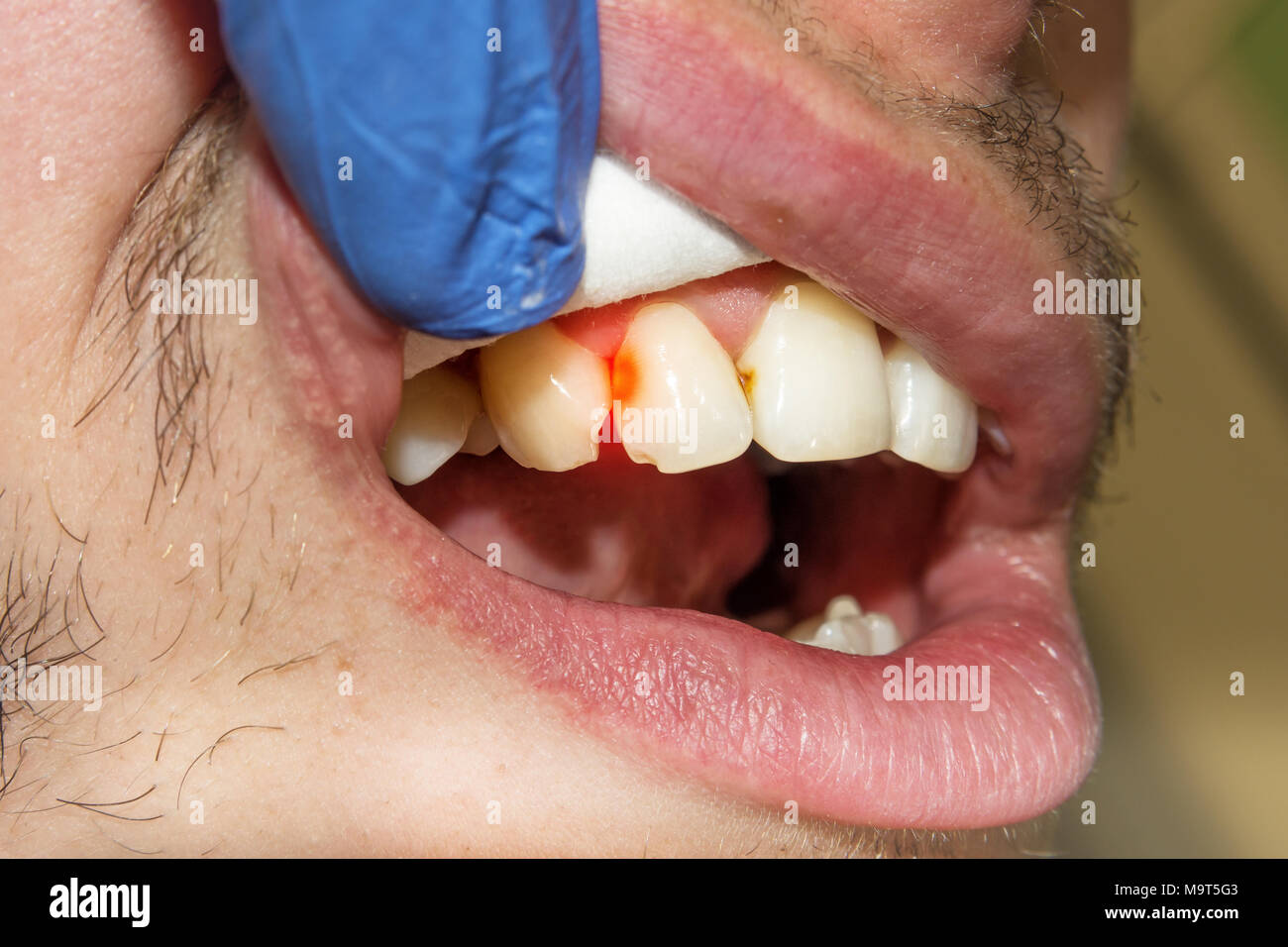 caries spoiled tooth closeup photographed through dental mirror Stock ...