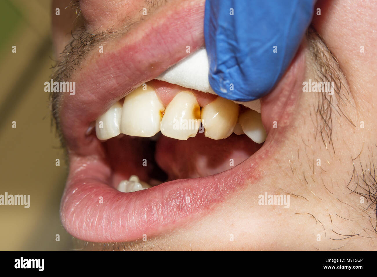 caries spoiled tooth closeup photographed through dental mirror Stock ...