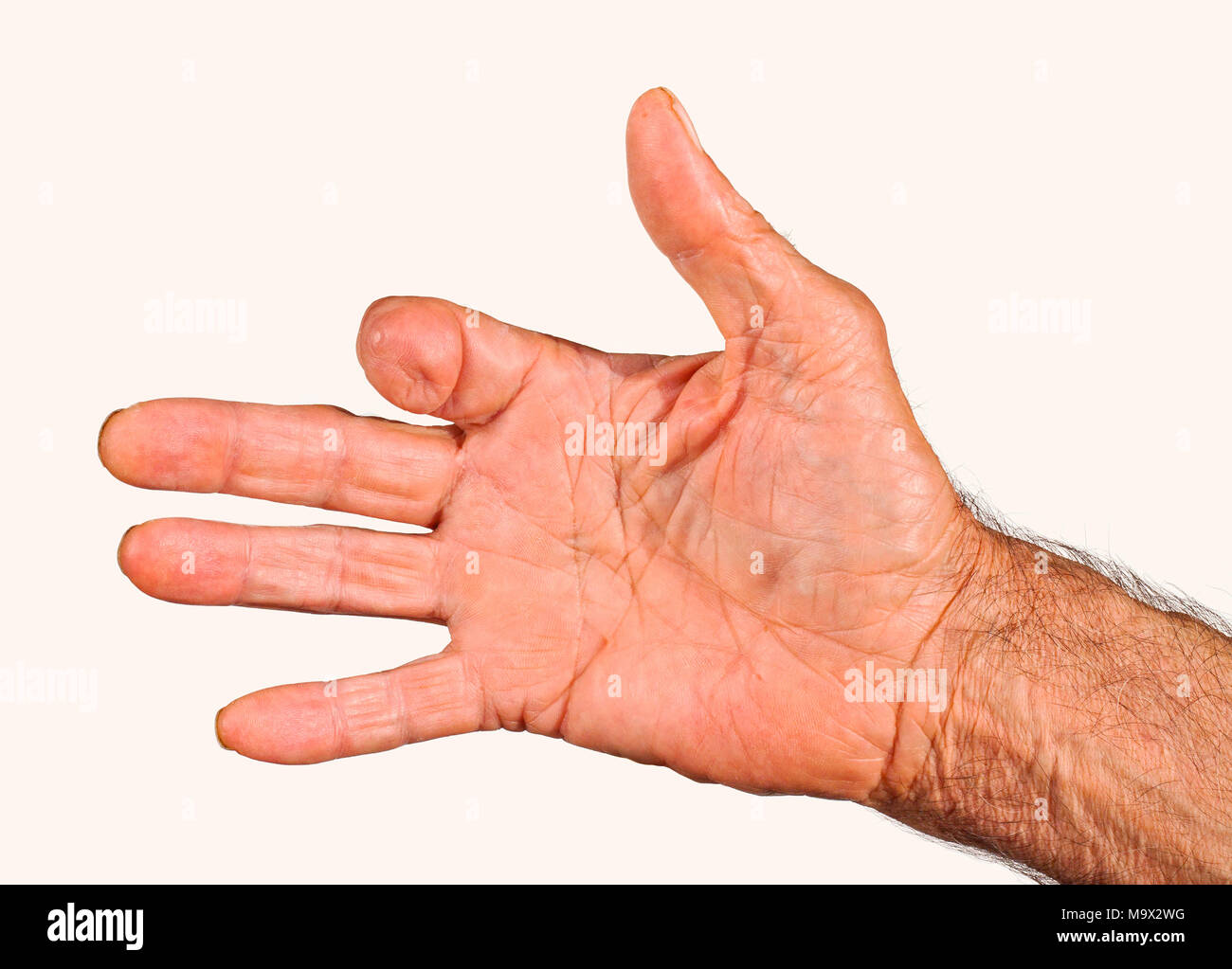 Amputated finger hi-res stock photography and images - Alamy