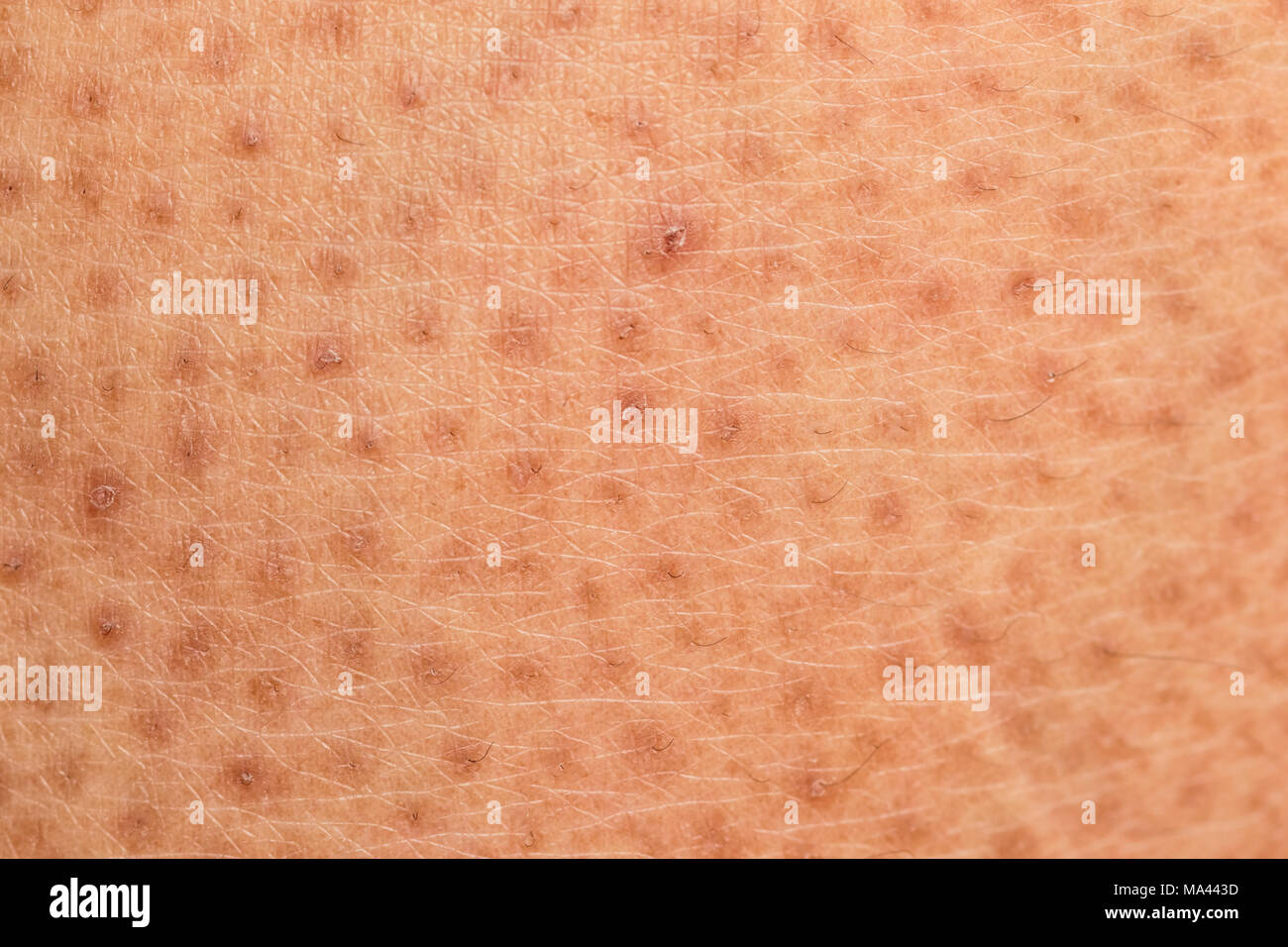 Closeup of skin problem,Dry skin ichthyosis vulgaris Stock Photo - Alamy