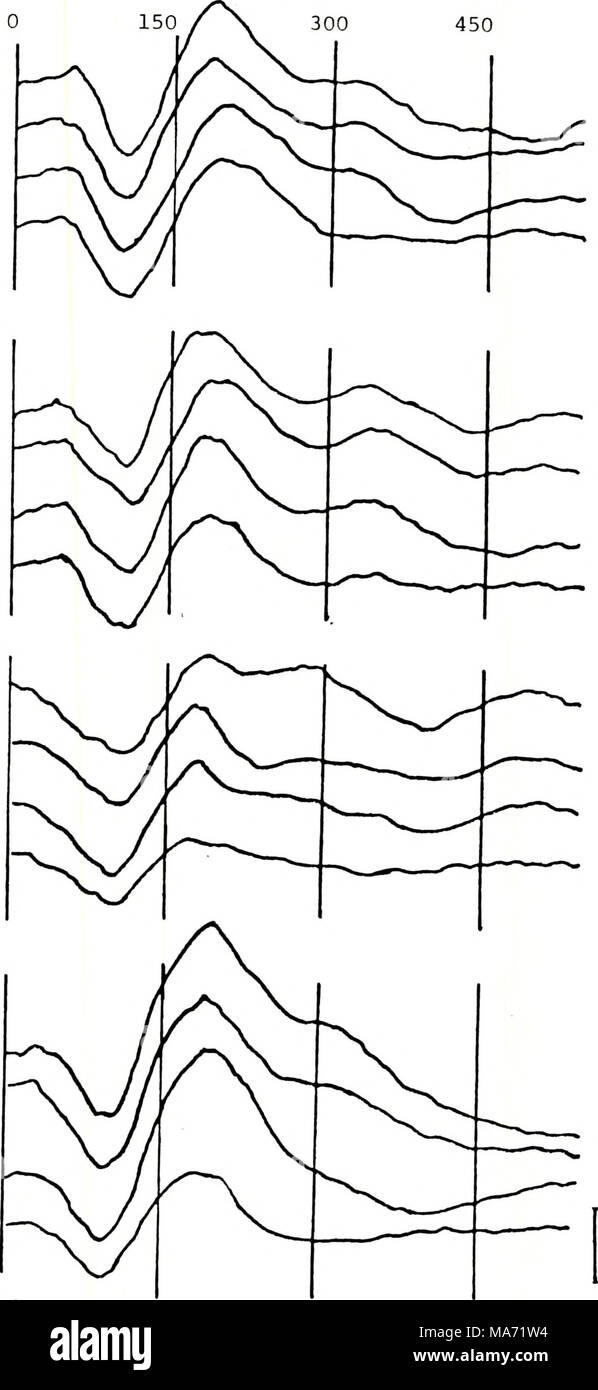 Auditory evoked potentials hi-res stock photography and images - Alamy