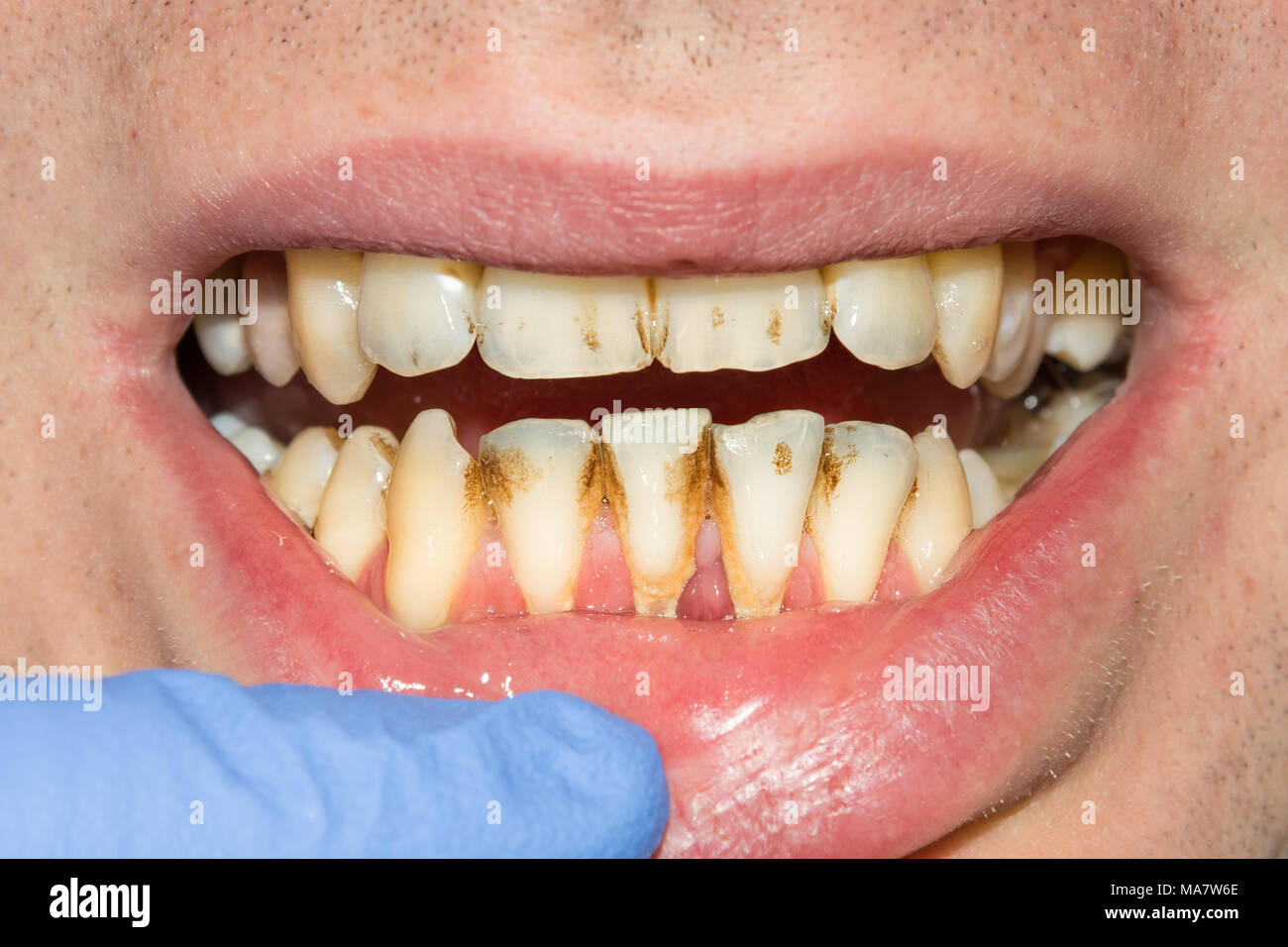 caries spoiled tooth closeup photographed through dental mirror Stock ...