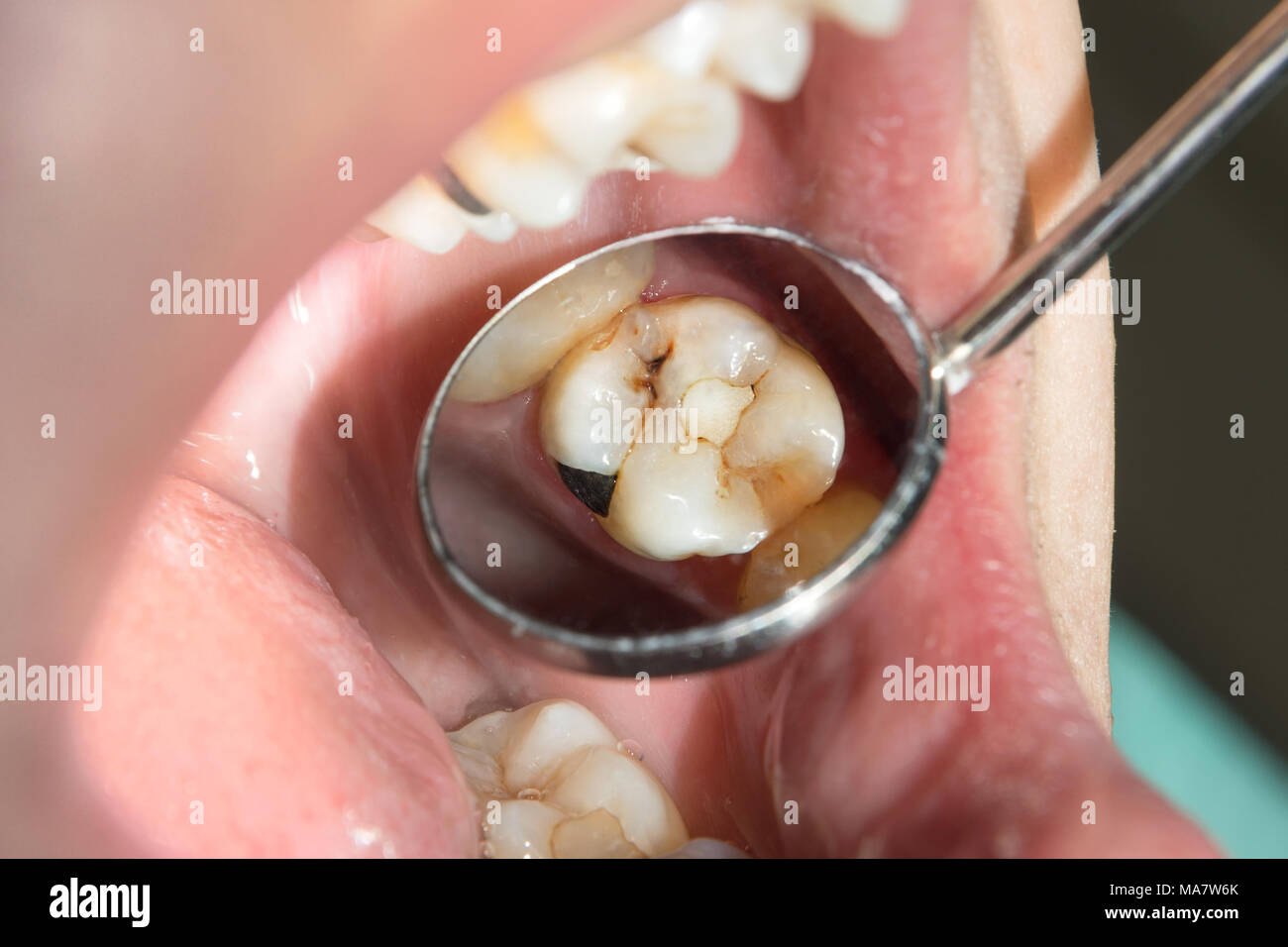 caries spoiled tooth closeup photographed through dental mirror Stock ...