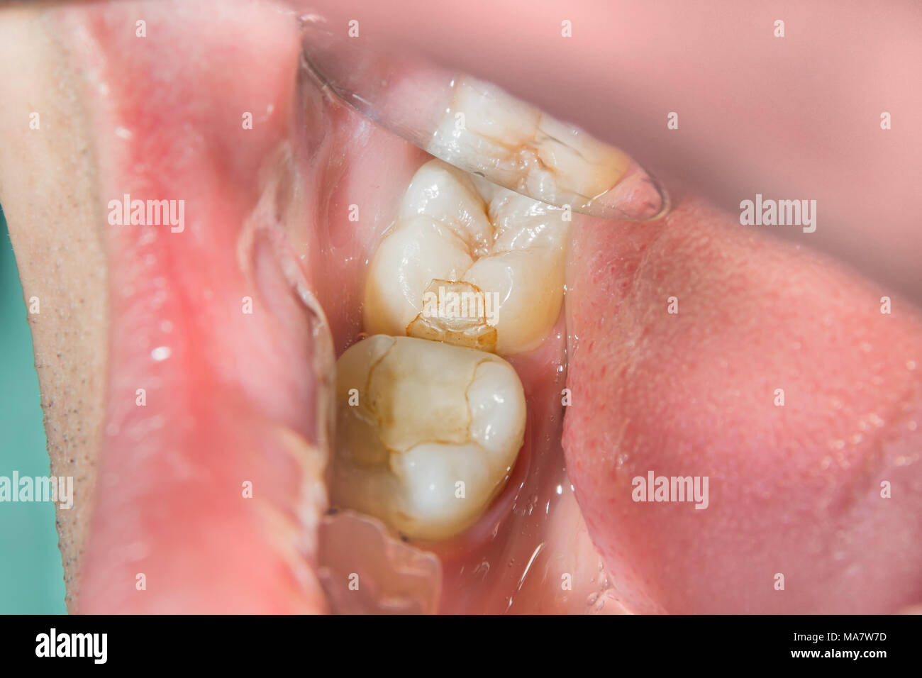 caries spoiled tooth closeup photographed through dental mirror Stock ...