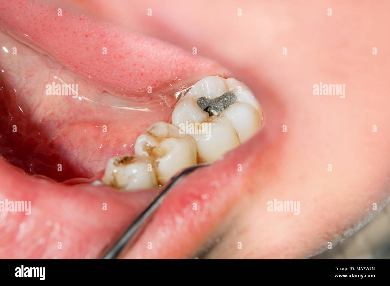 caries spoiled tooth closeup photographed through dental mirror Stock ...