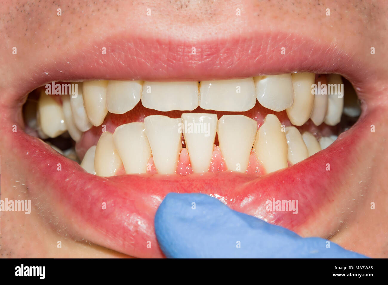 caries spoiled tooth closeup photographed through dental mirror Stock ...