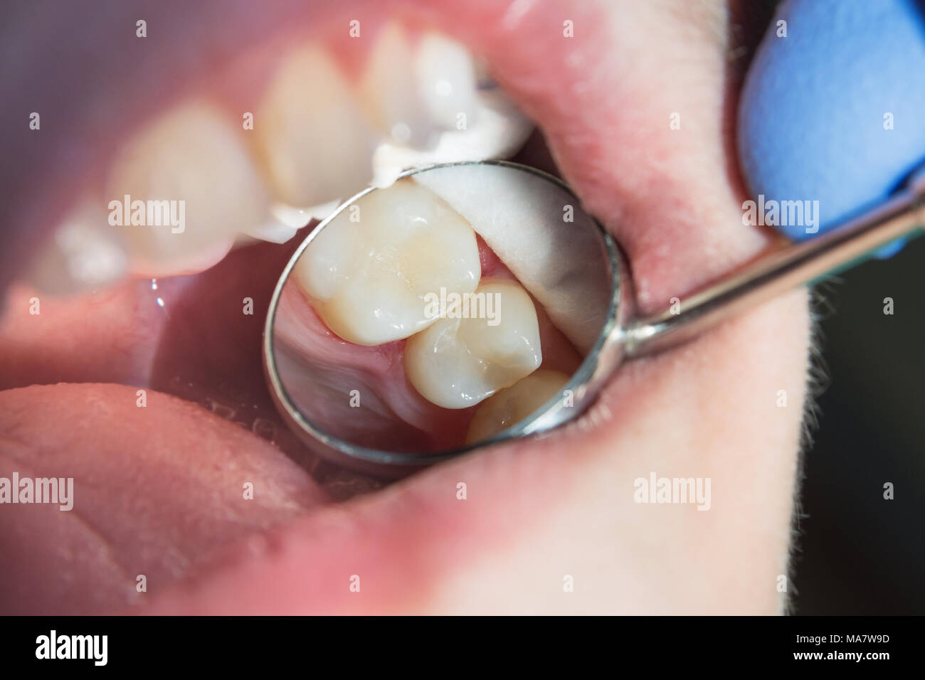 caries spoiled tooth closeup photographed through dental mirror Stock ...