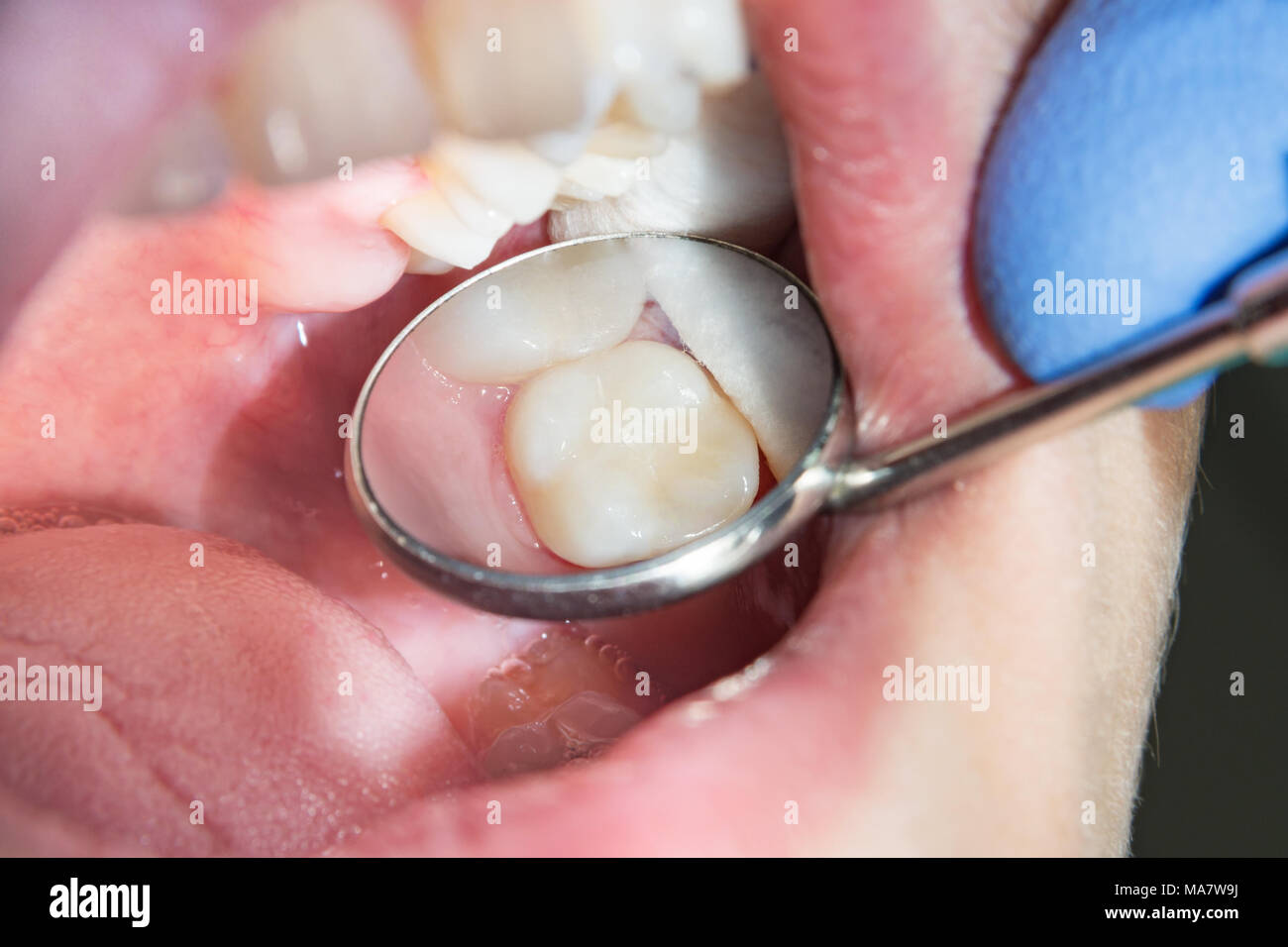caries spoiled tooth closeup photographed through dental mirror Stock ...