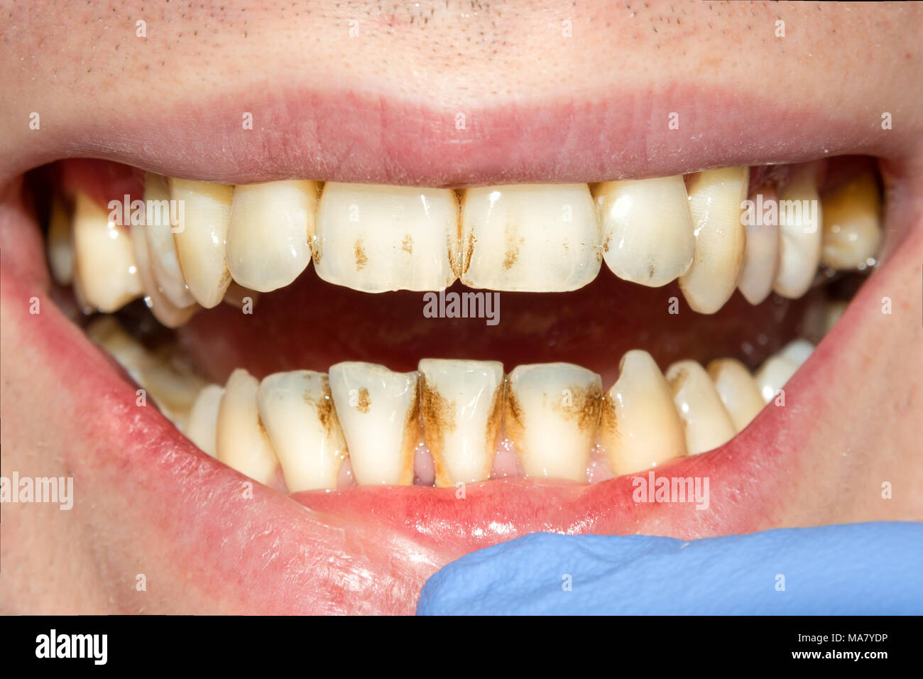 Amalgam fillings in a mouth hi-res stock photography and images - Alamy
