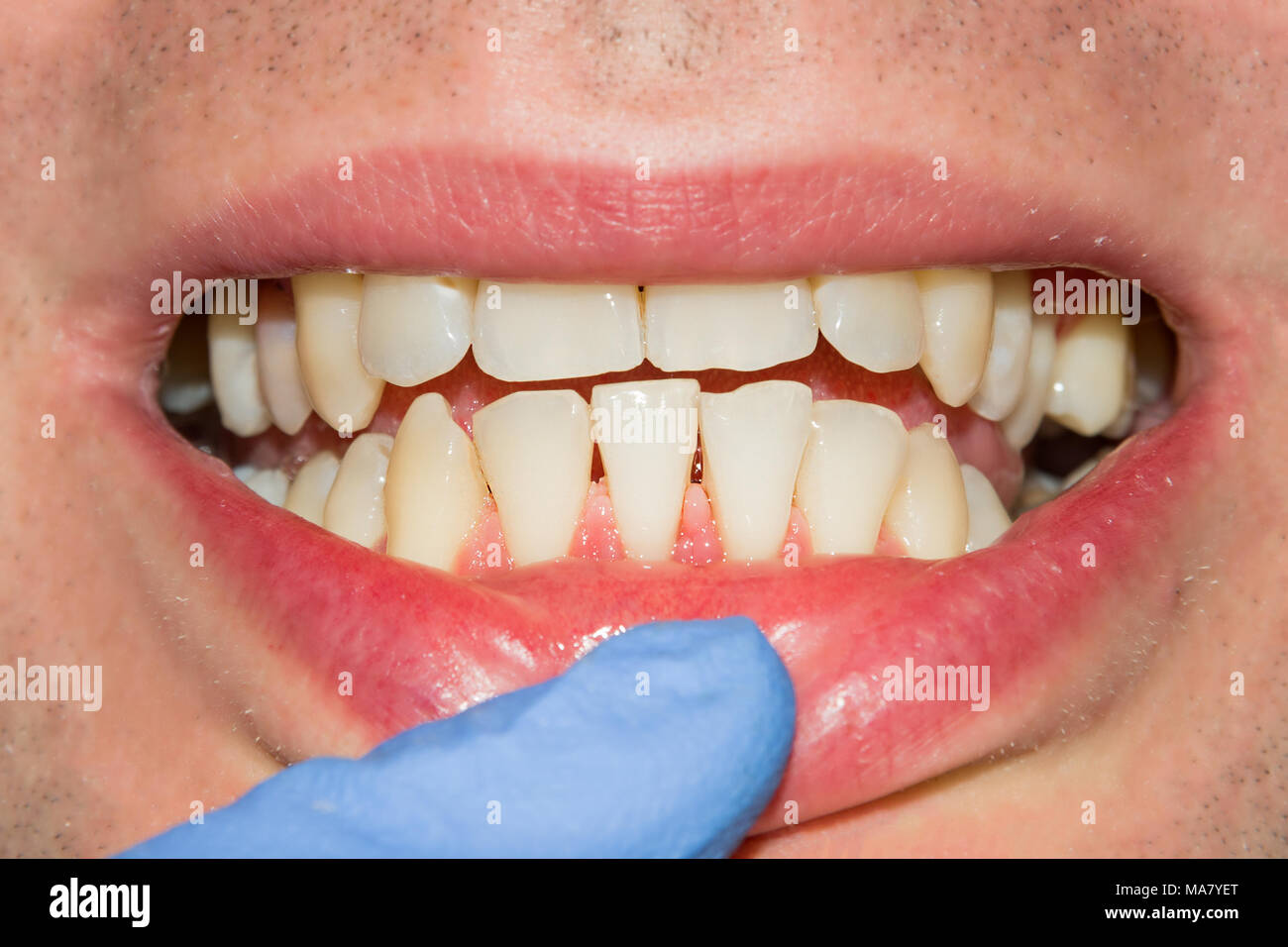 Amalgam and composite fillings hi-res stock photography and images - Alamy