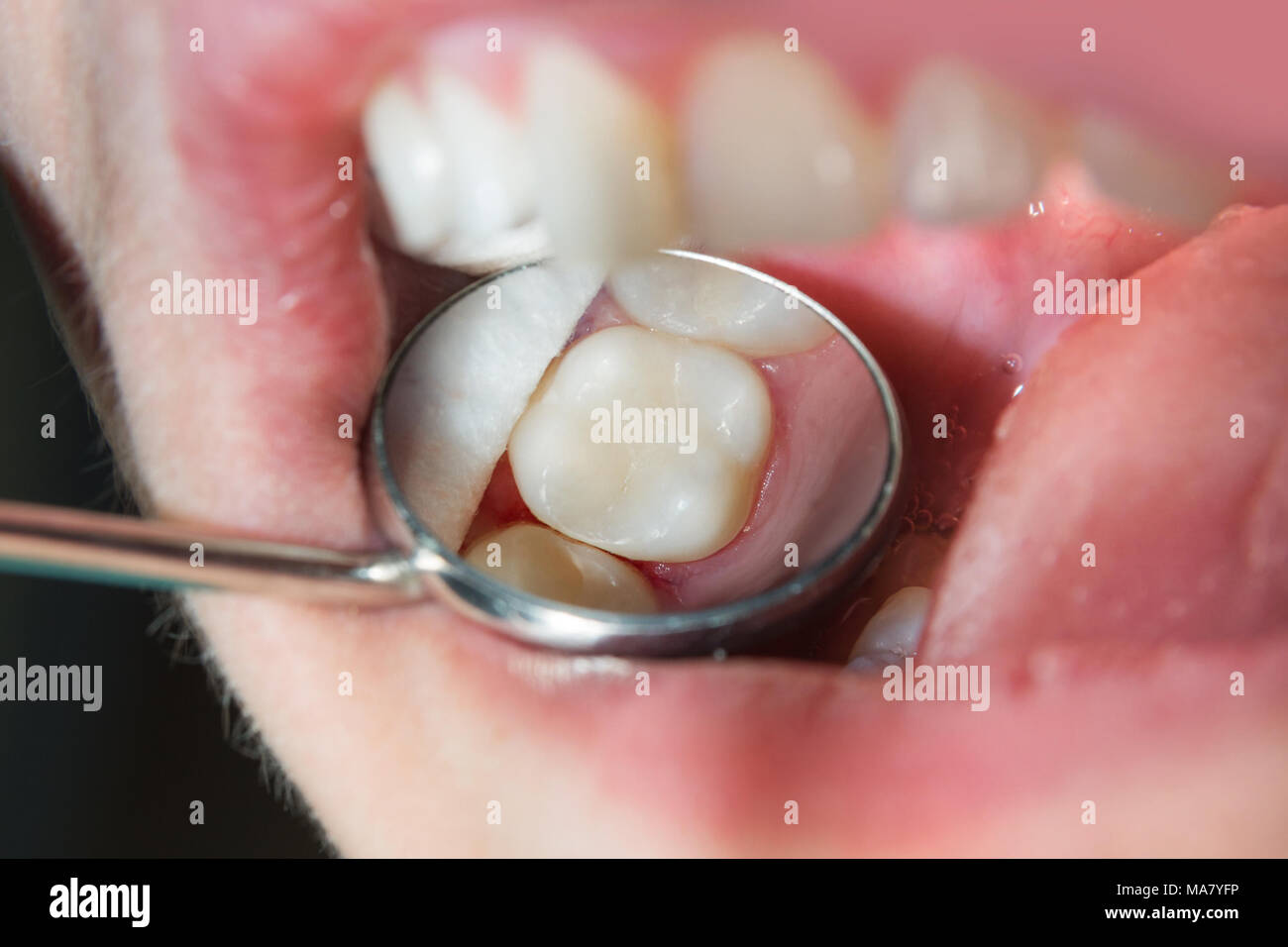 close-up of a human rotten carious tooth at the treatment stage in a ...