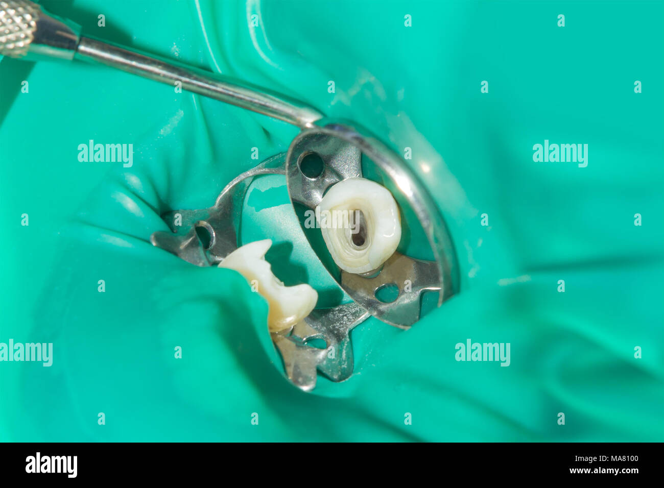 Sealing of teeth hi-res stock photography and images - Alamy